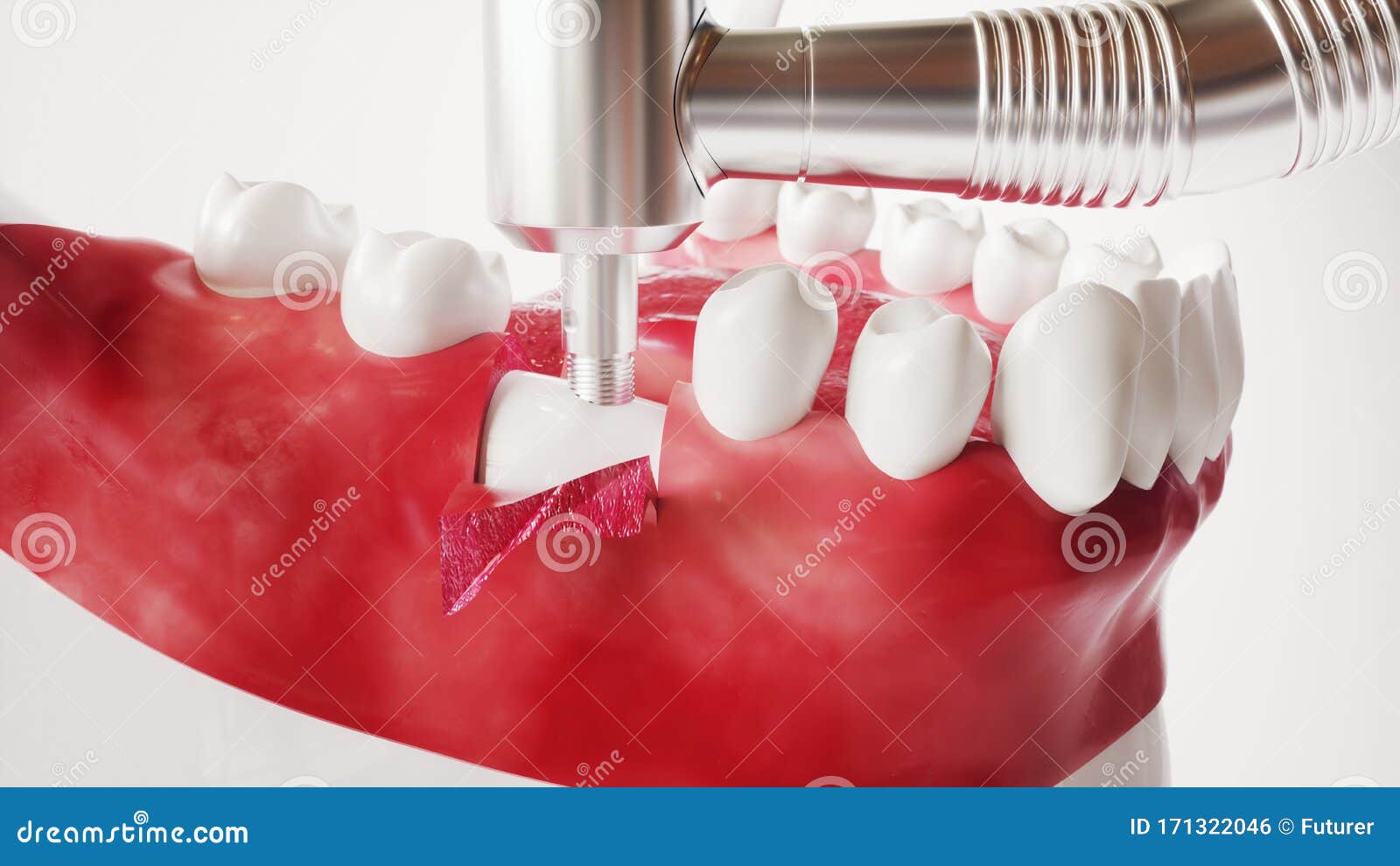 Extraction And Implantation, Complex Immediate Surgery. Medically ...