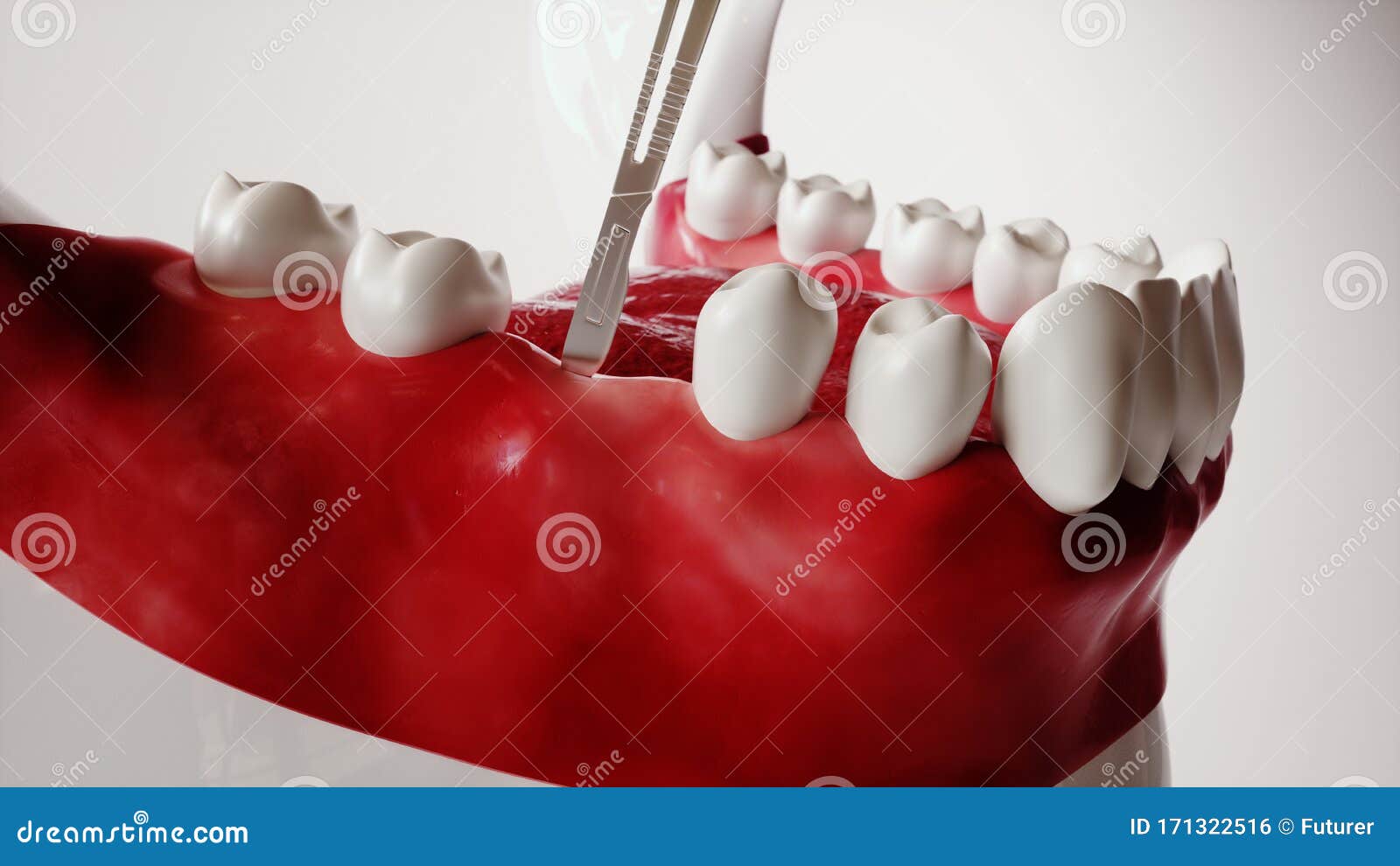 Extraction And Implantation, Complex Immediate Surgery. Medically ...