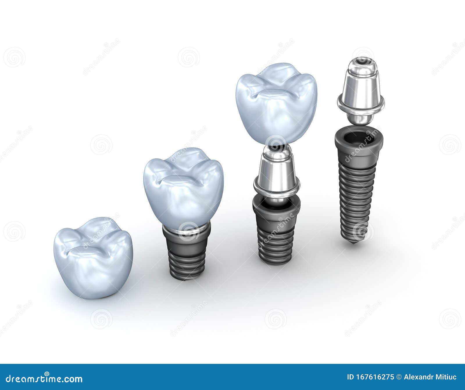 Tooth Implants Set Isolated on White Background Stock Illustration ...
