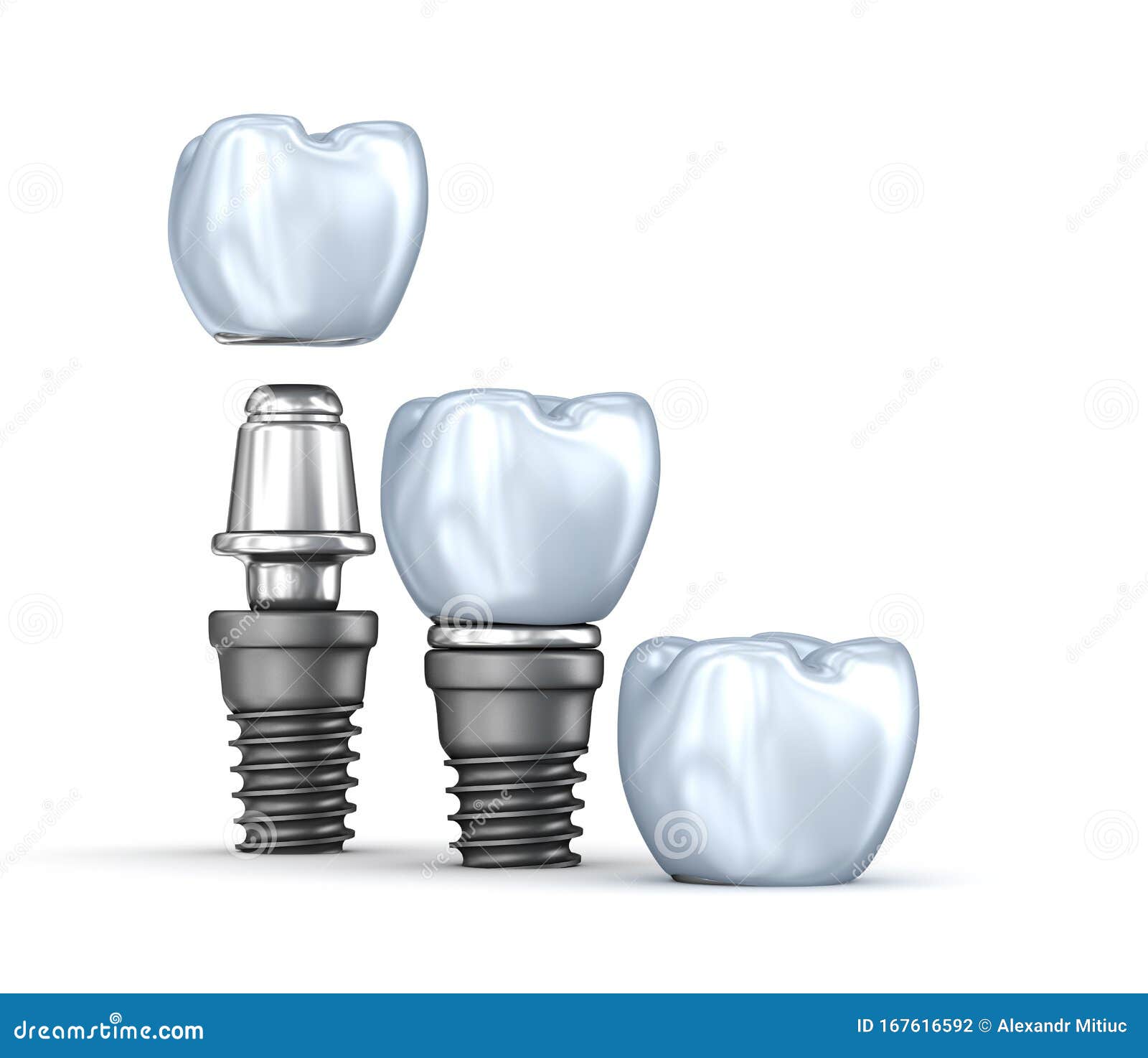 Tooth Implants Set Isolated on White Background Stock Illustration ...