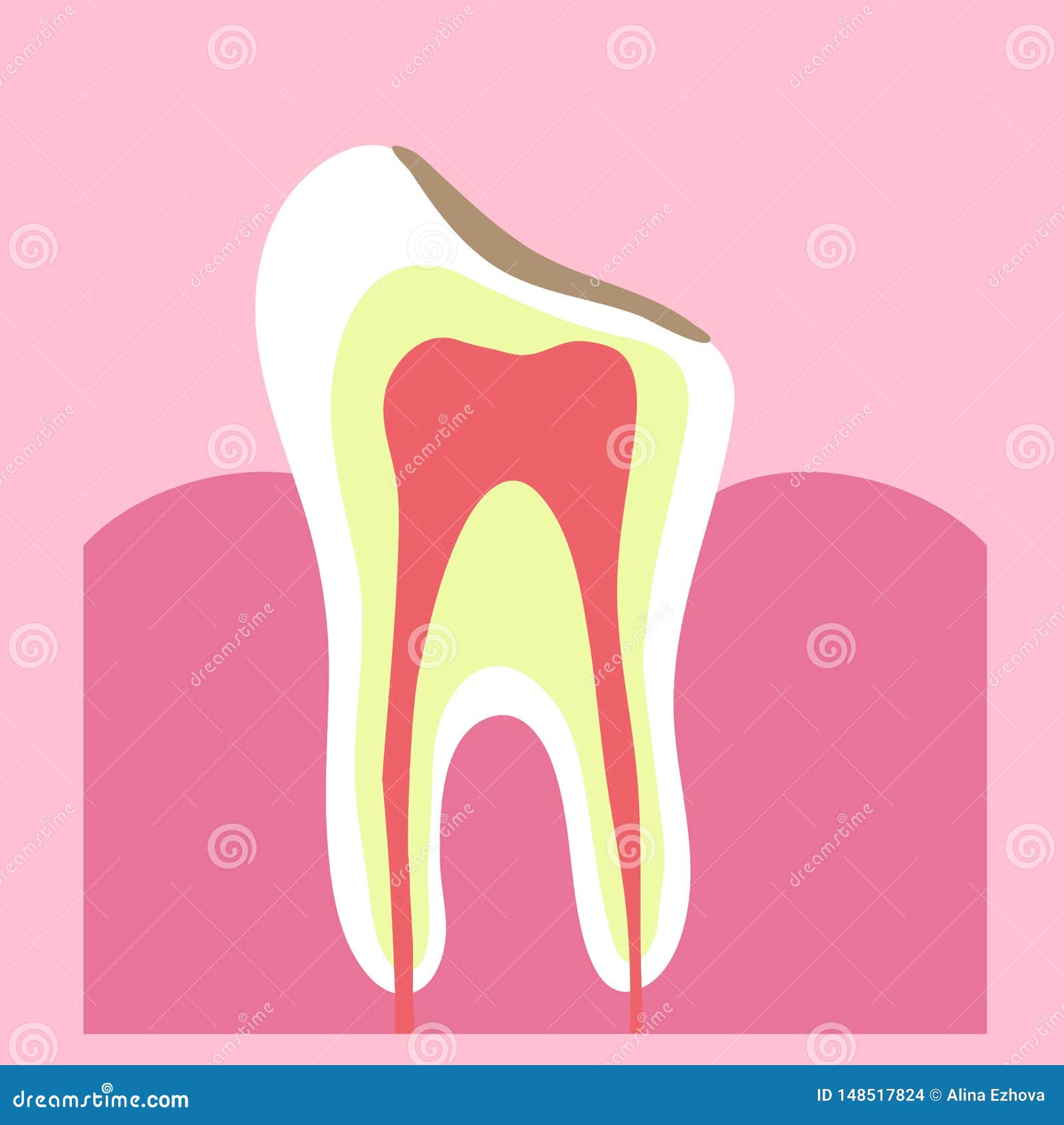 Tooth and Initial Caries on it on a Pink Background. Stock Vector ...