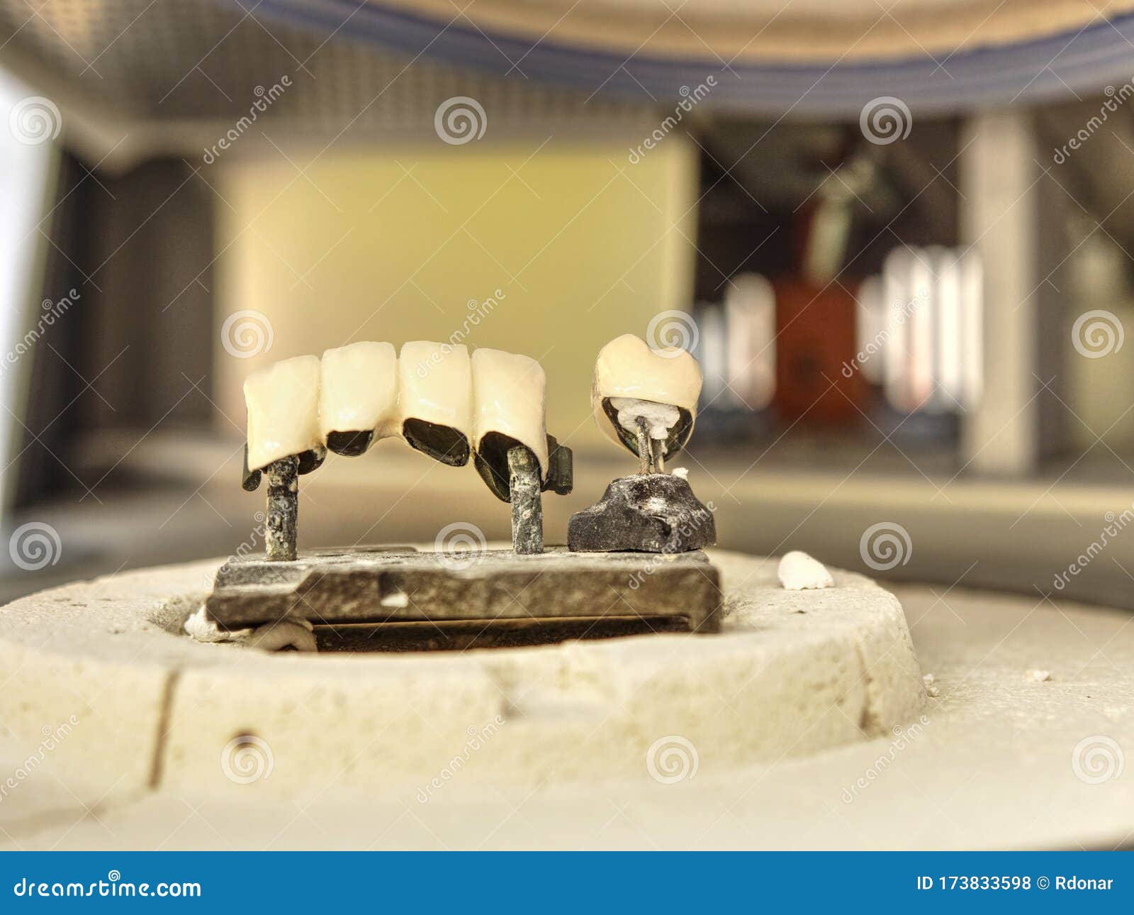 Tooth, Metal Ceramic Crown on the Table Stock Photo - Image of human ...