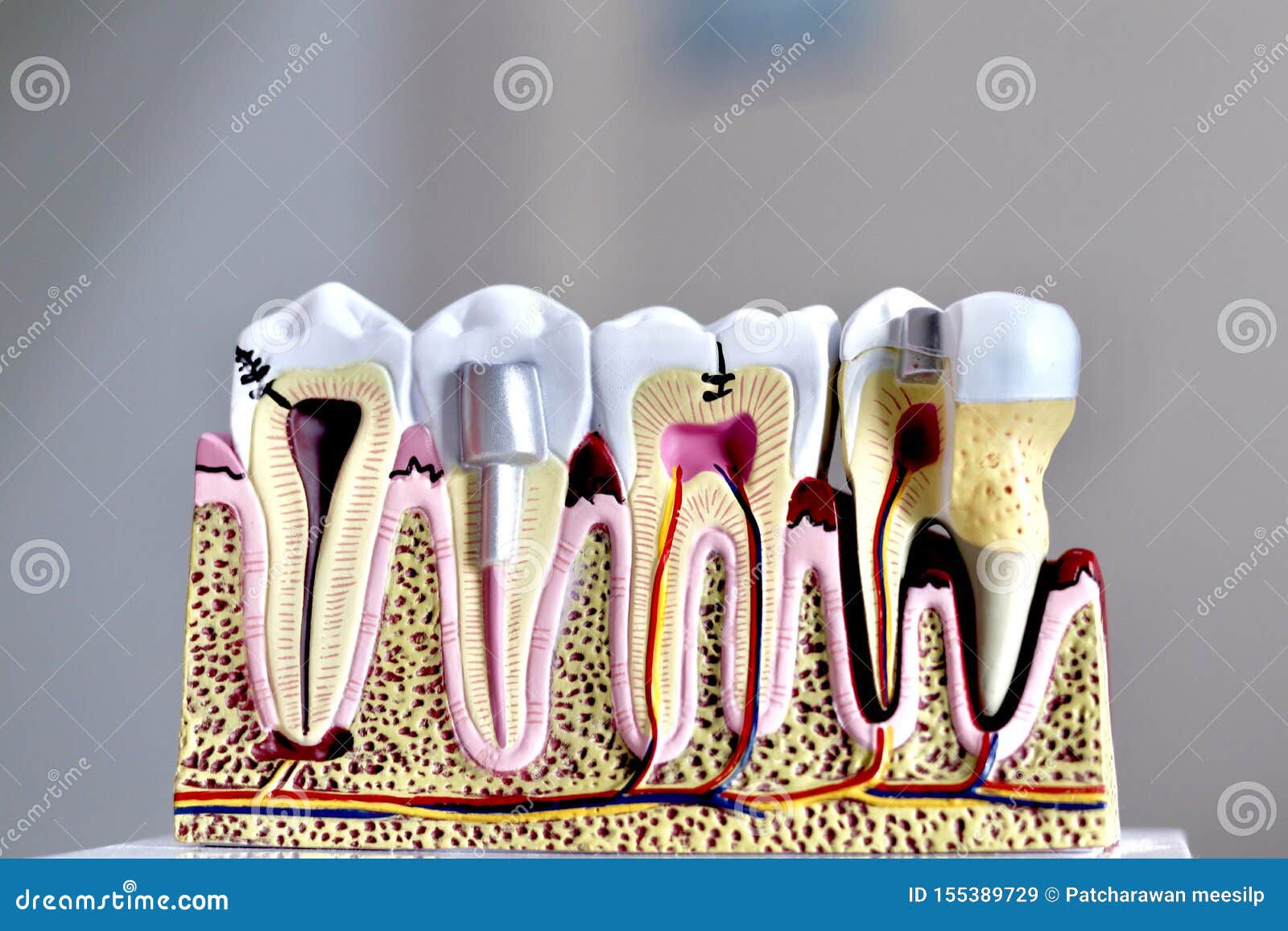 Tooth model stock image. Image of dentist, health, care - 155389729