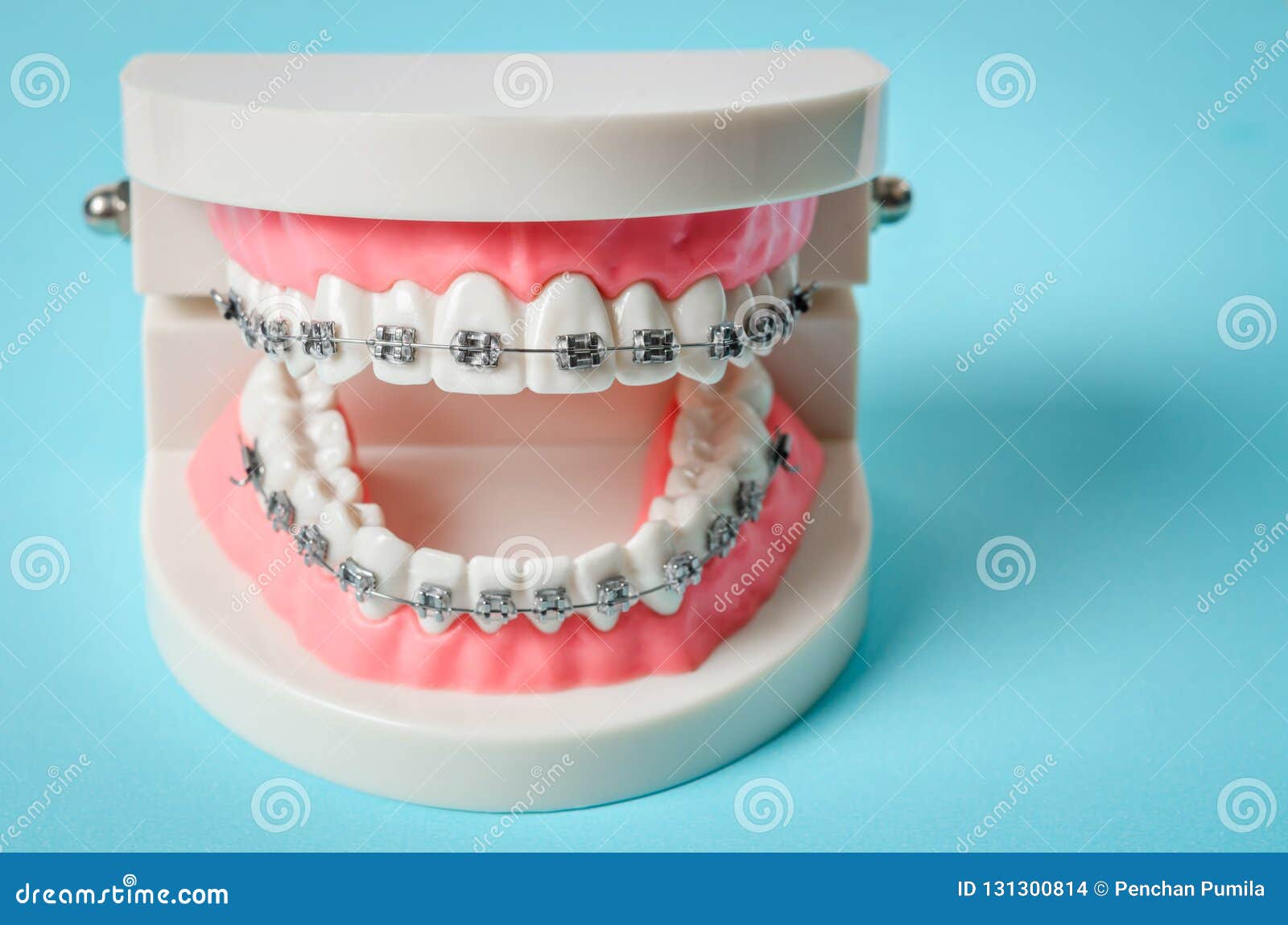 Tooth Model with Metal Wire Dental Braces. Stock Photo - Image of ...