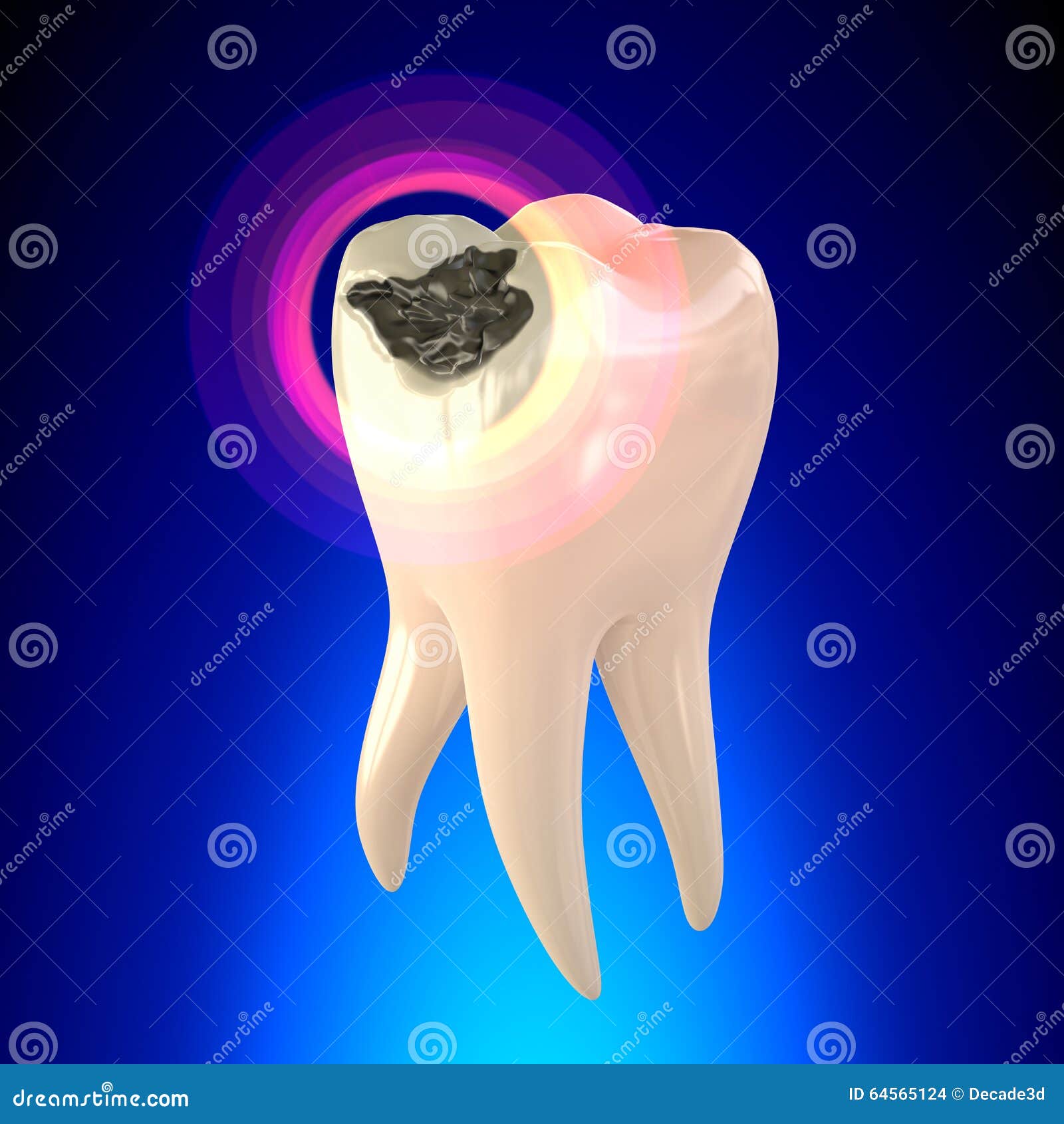 Tooth Molar with Dental Caries Stock Illustration - Illustration of ...