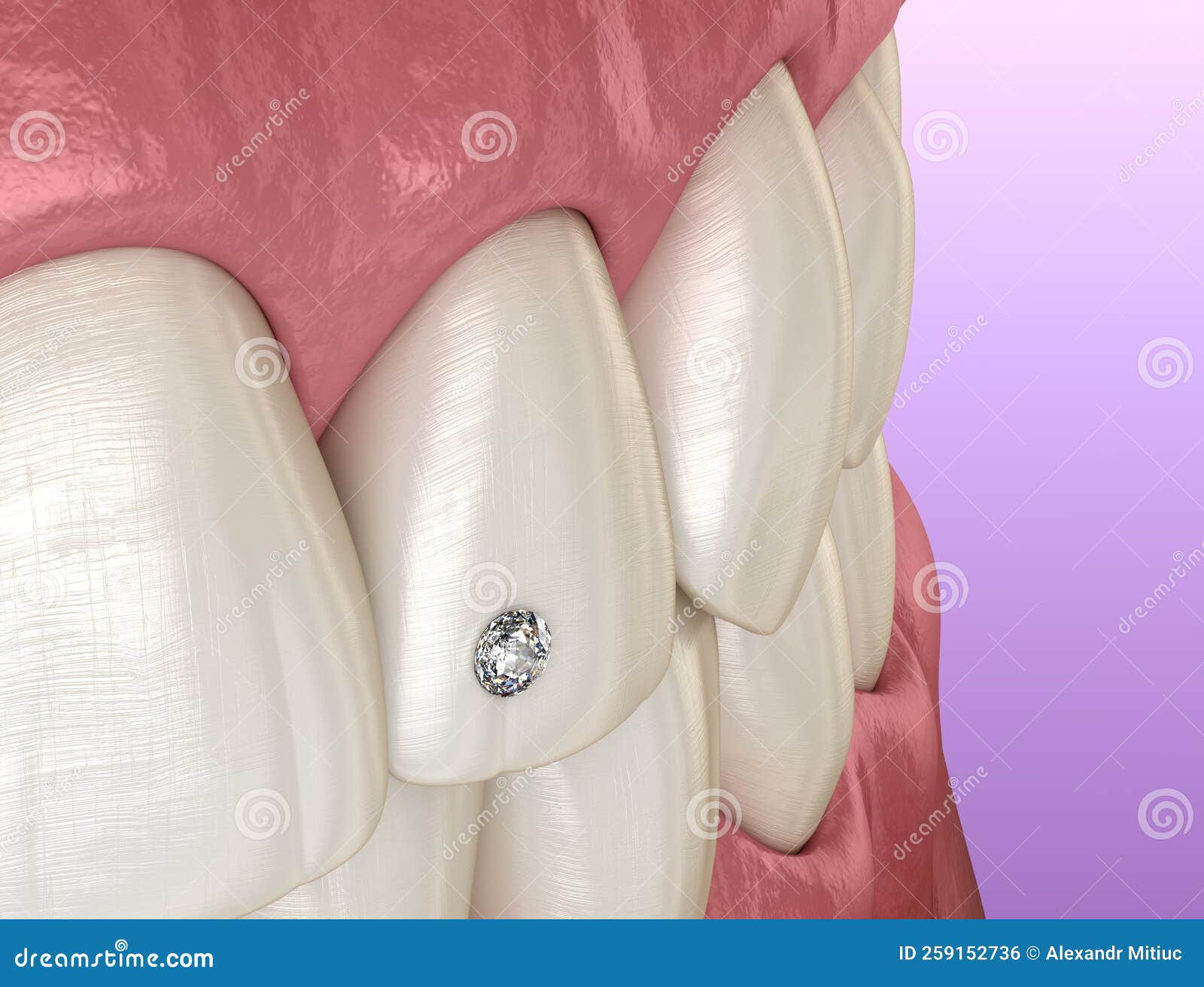 Tooth Piercing by Diamond, 3D Illustration Concept Stock Illustration ...