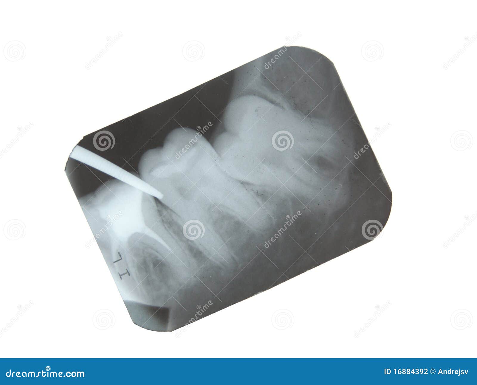 Tooth x-ray stock photo. Image of examination, black - 16884392