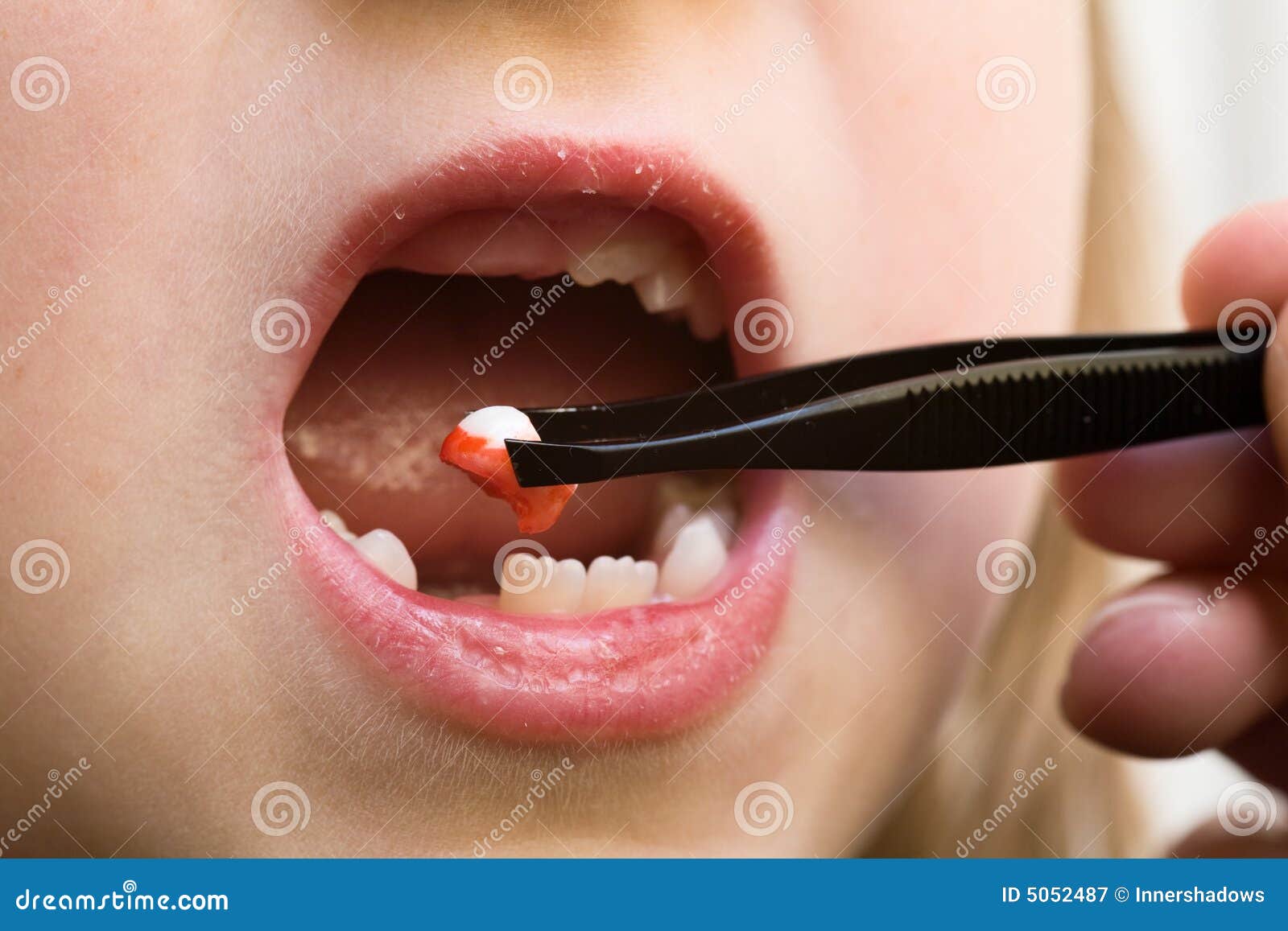 Tooth Removal Royalty Free Stock Photography - Image: 5052487