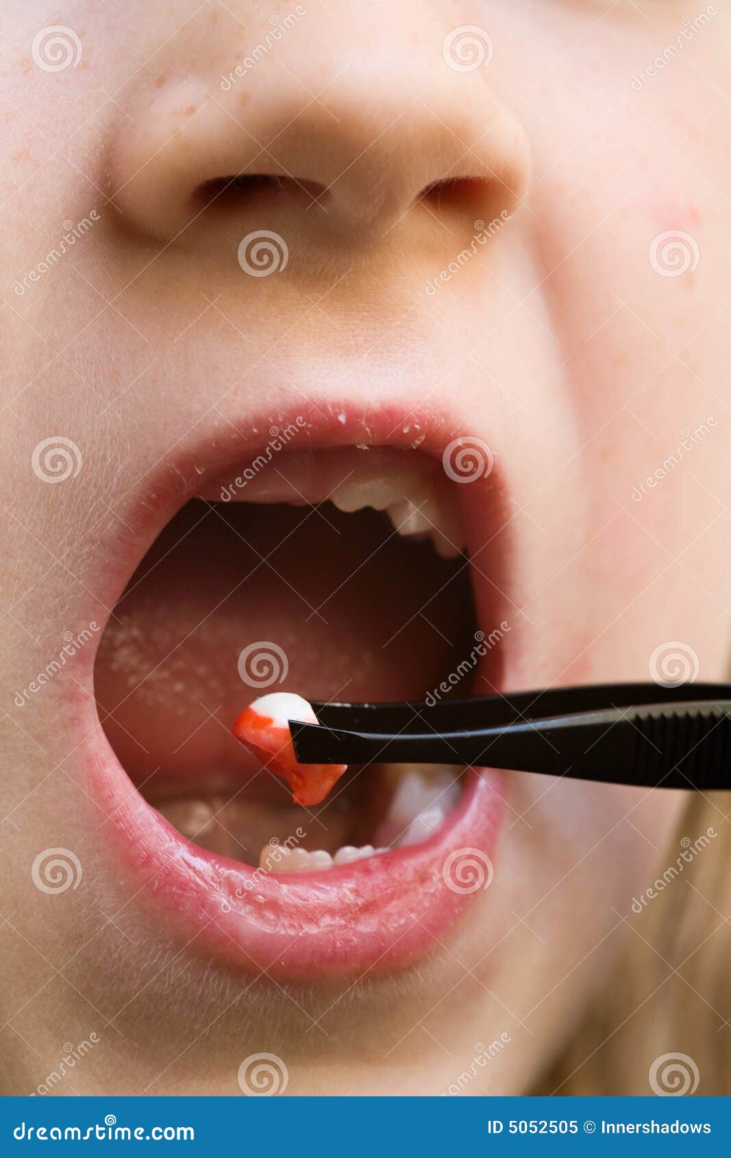Tooth removal stock image. Image of dentist, mouth, tooth - 5052505