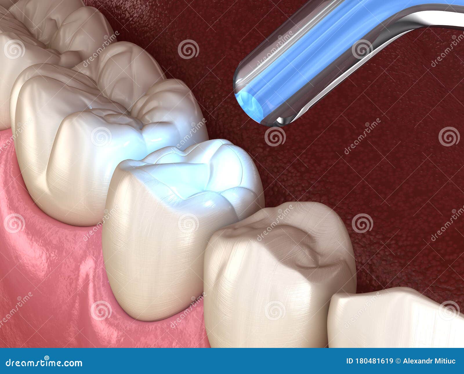 Tooth Restoration. Installing A New Veneer On A Discolored Tooth ...