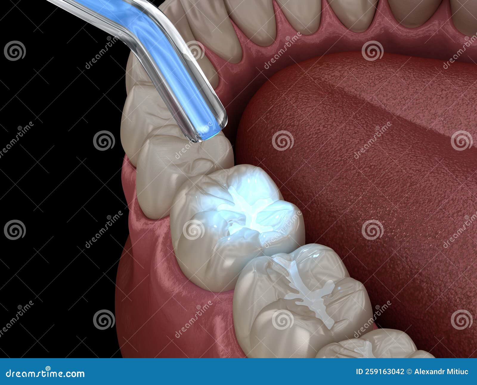 Tooth Restoration. Installing A New Veneer On A Discolored Tooth ...