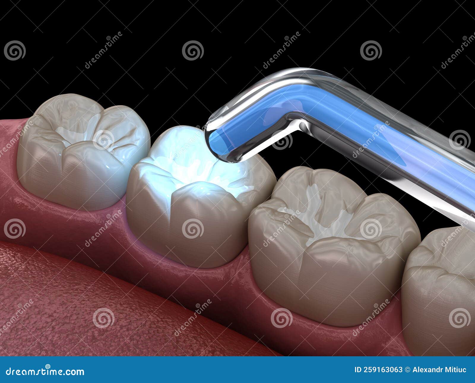 Tooth Restoration with Filling and Polymerization Lamp. Medically ...