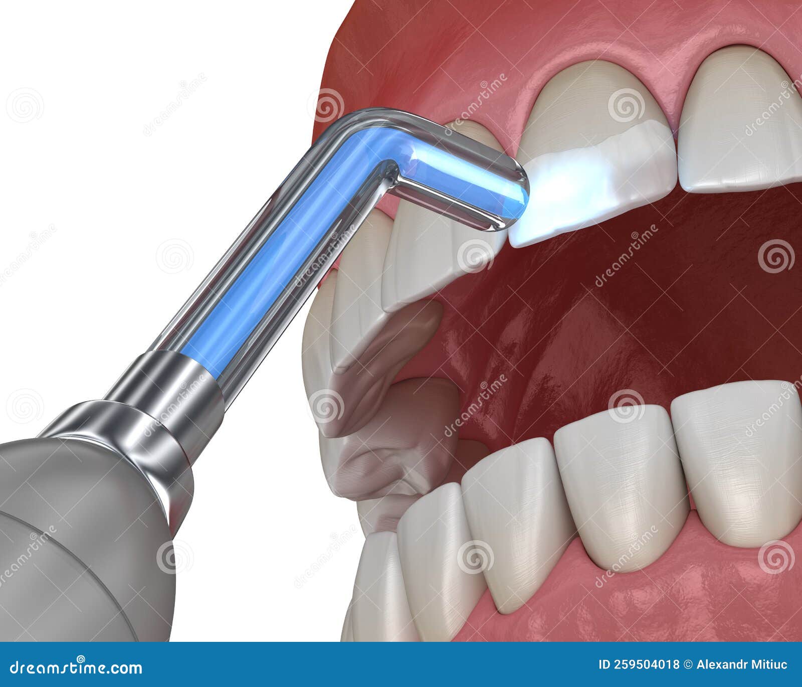 Tooth Restoration. Installing A New Veneer On A Discolored Tooth ...