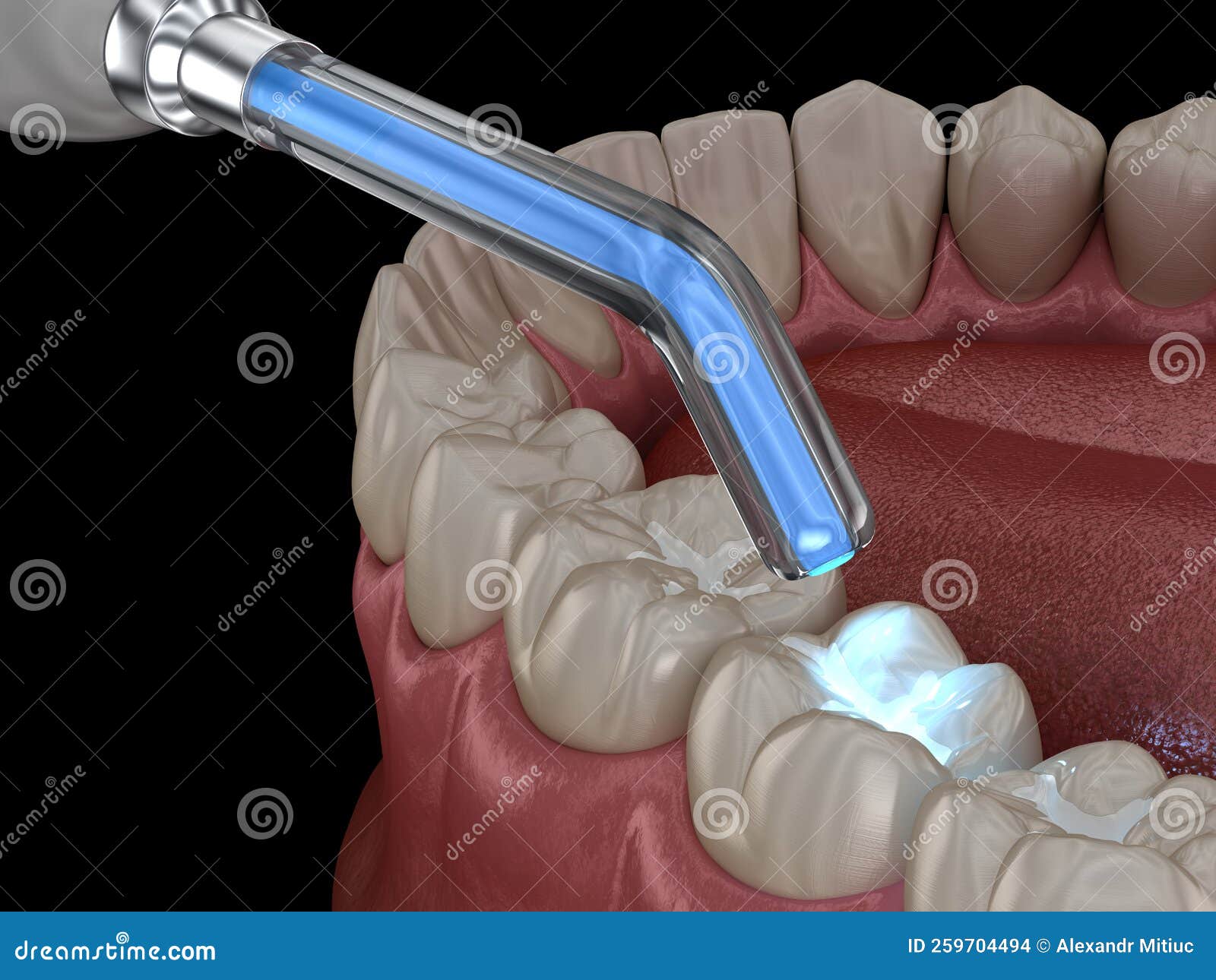Tooth Restoration with Filling and Polymerization Lamp. Medically ...