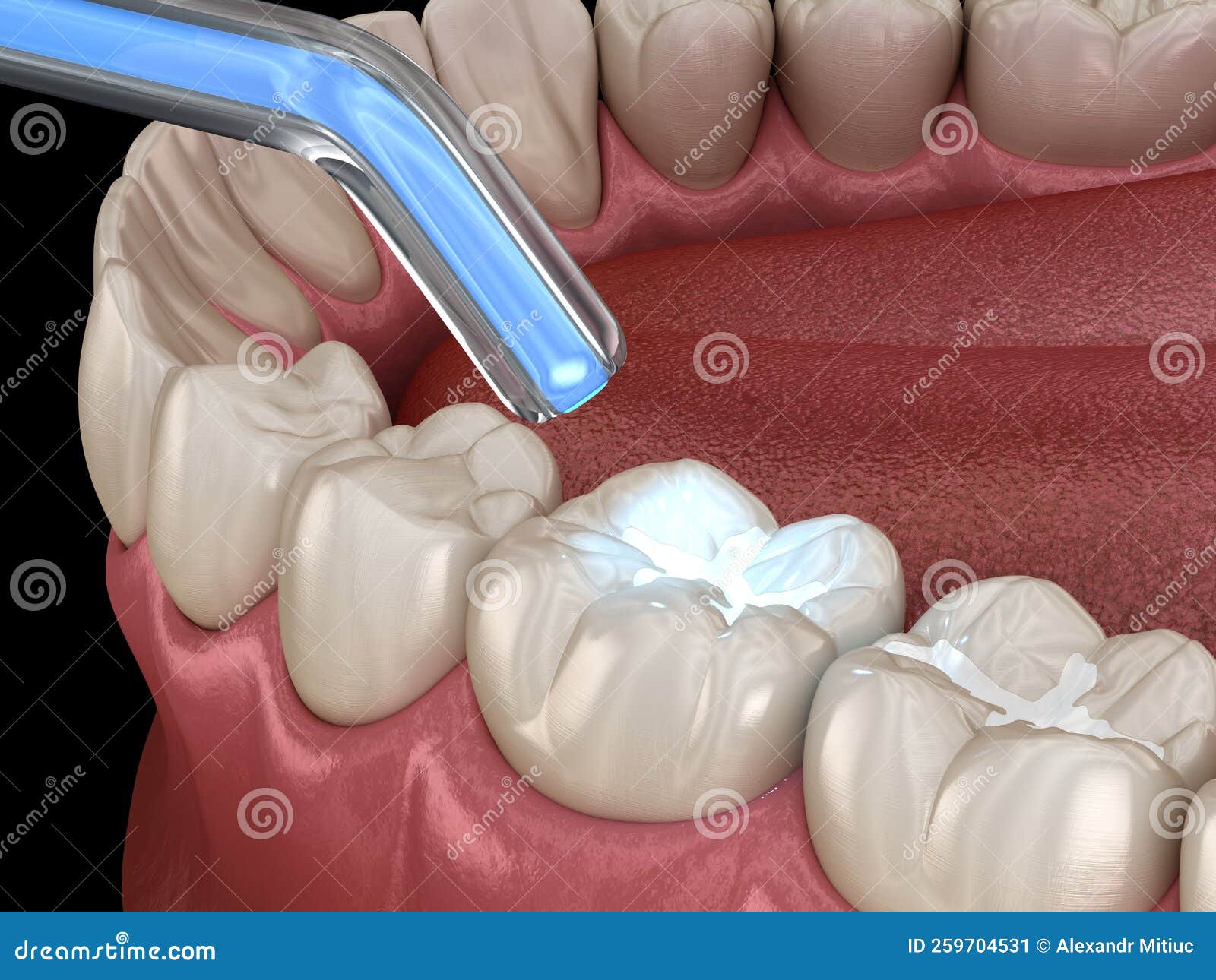 Tooth Restoration With Filling And Polymerization Lamp. Medically ...