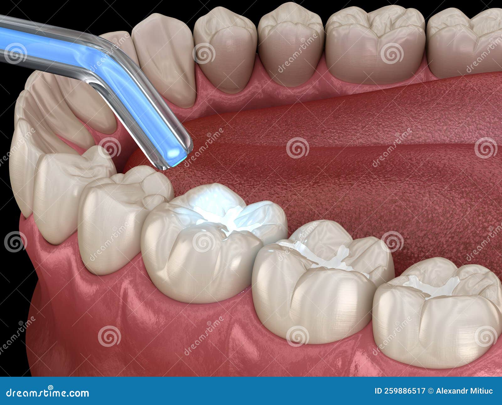Tooth Restoration with Filling and Polymerization Lamp. Medically ...