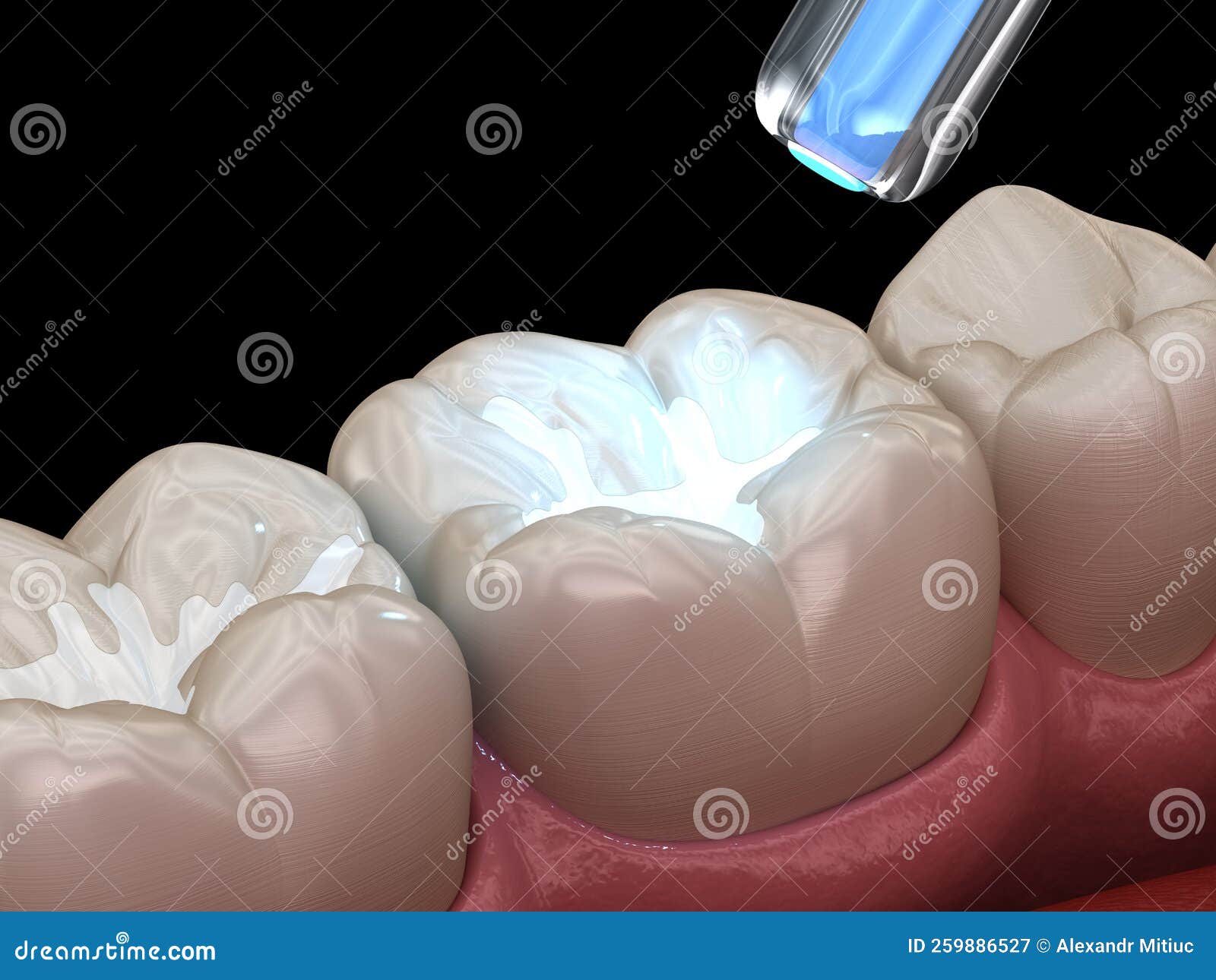 Tooth Restoration with Filling and Polymerization Lamp. Medically ...