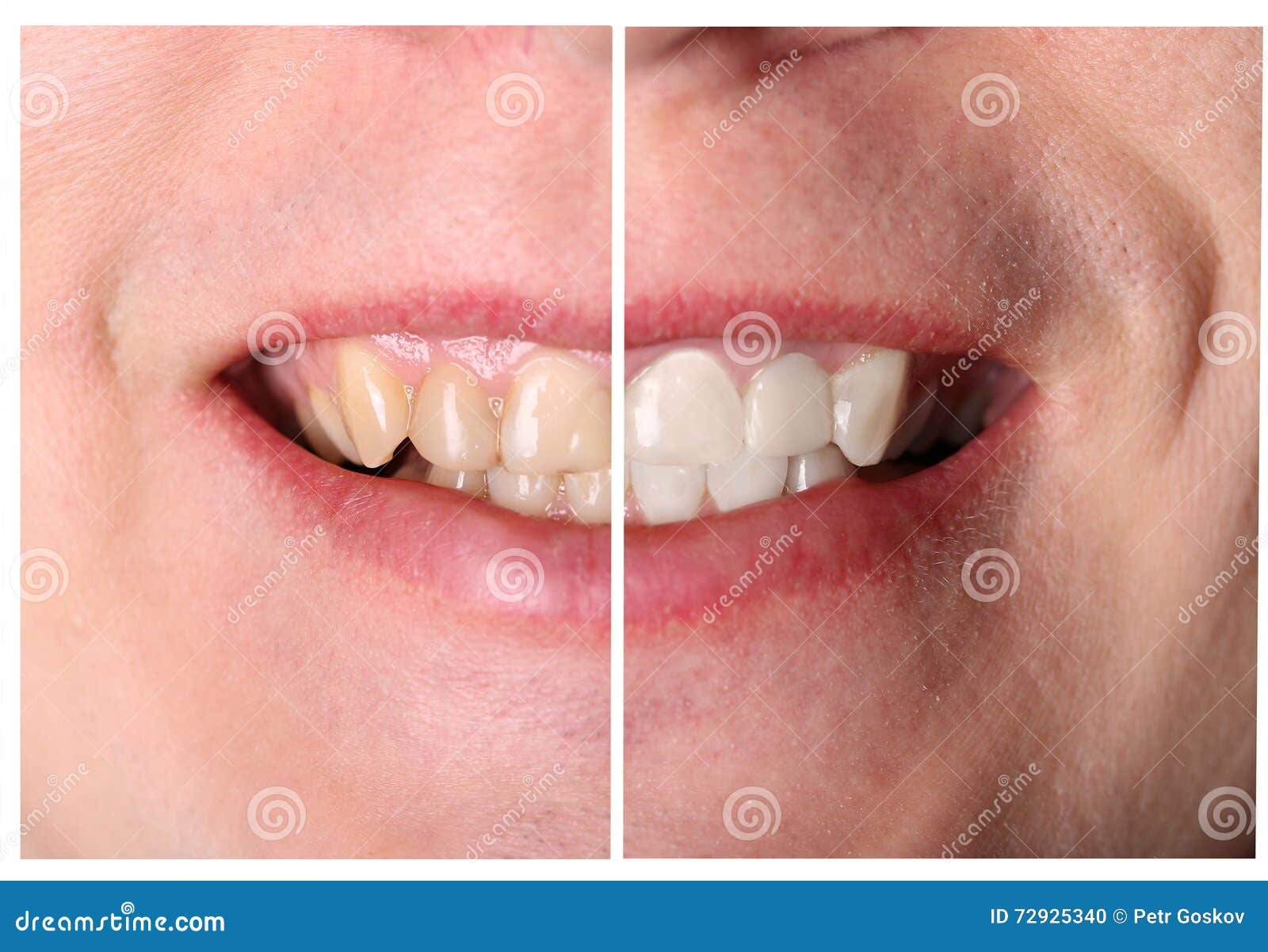 Tooth Restoration before and after Treatment Stock Photo - Image of ...