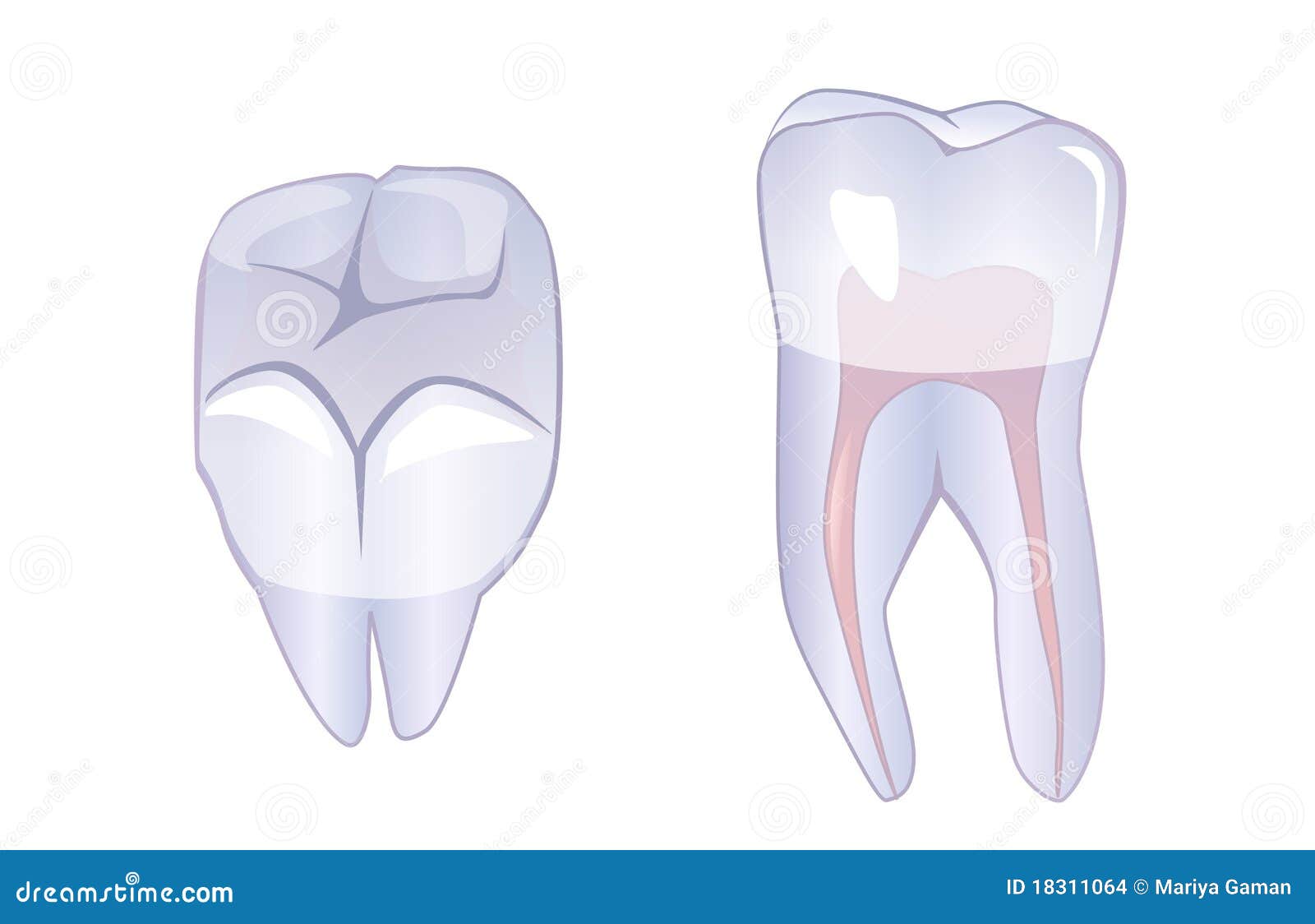 Pulpitis. Root Canal Therapy. Infected Pulp Is Removed From The Tooth ...