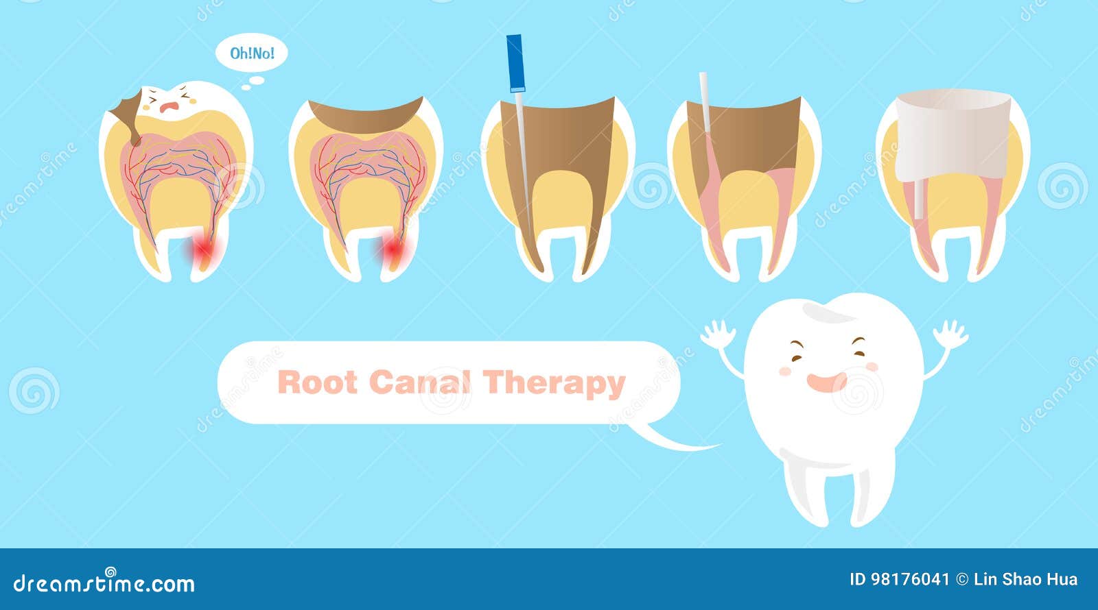 Tooth with Root Canal Therapy Stock Vector - Illustration of comic ...
