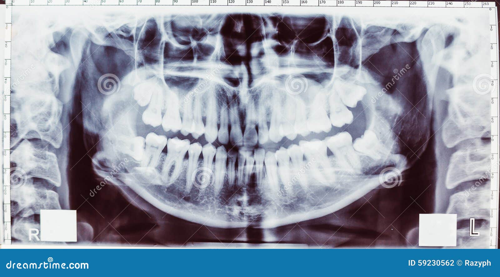 Tooth s radiography stock illustration. Illustration of dental - 59230562