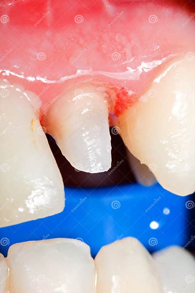 Tooth stub for crown stock photo. Image of discolored - 13823948