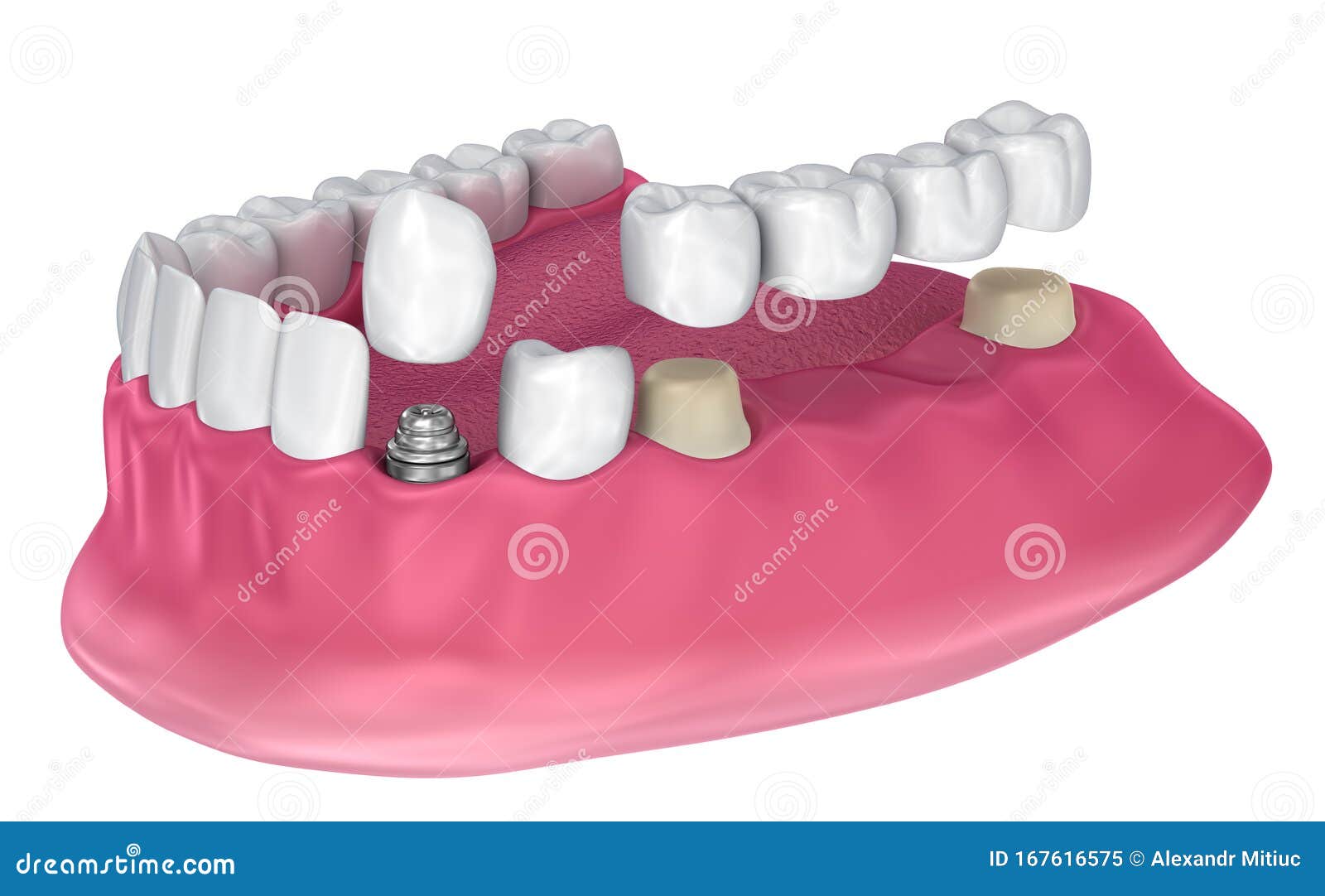 Tooth Supported Fixed Bridge, Implant and Crown. Medically Accurate ...
