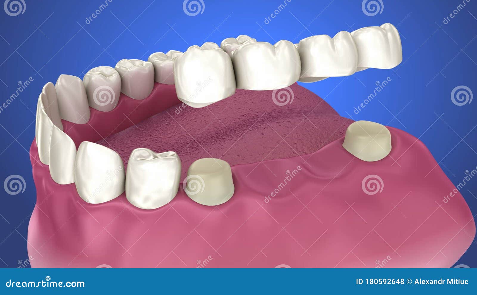 Tooth Supported Fixed Bridge Instalation Process . Medically Accurate ...