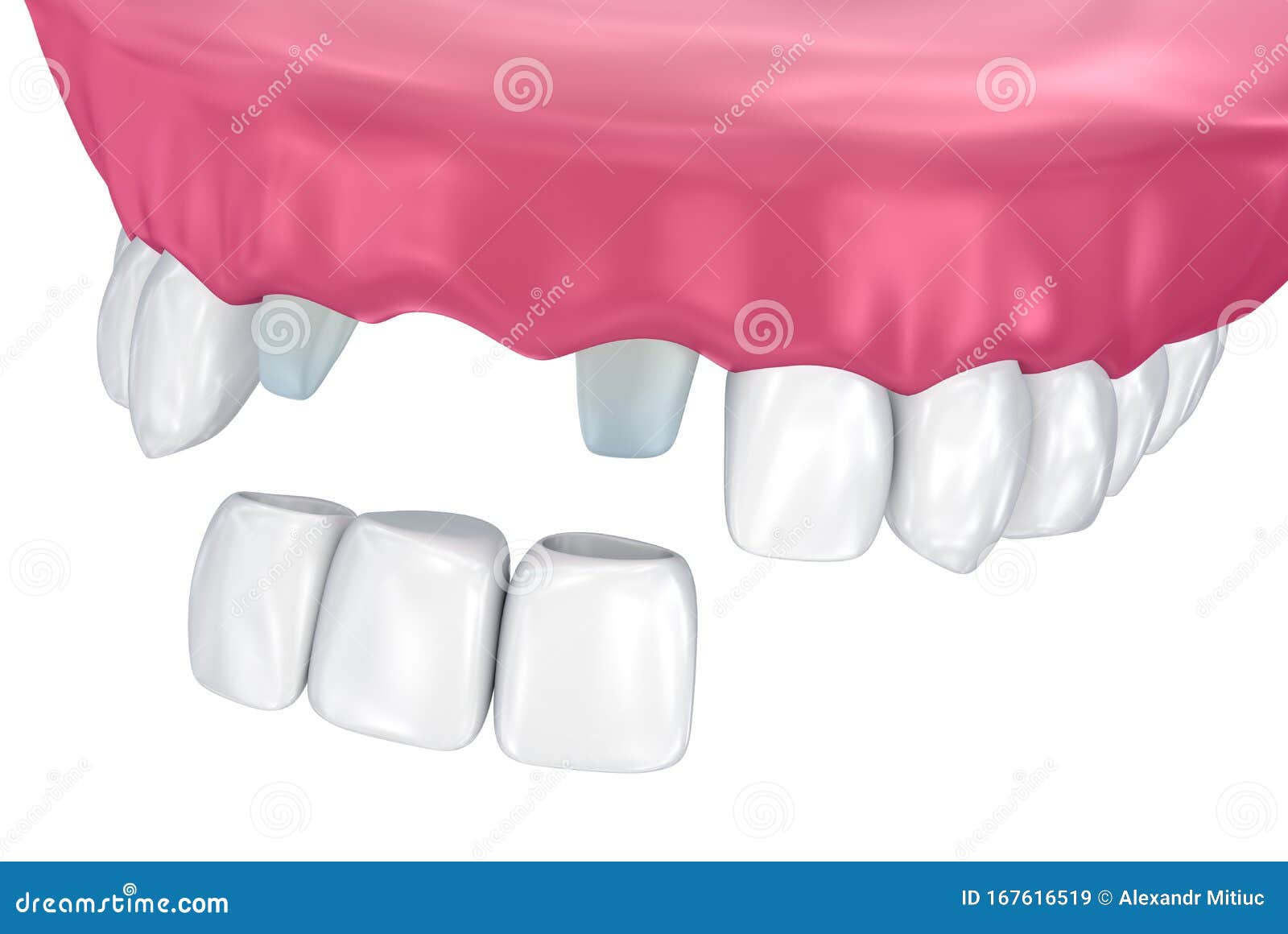 Tooth Supported Fixed Bridge. Medically Accurate Stock Illustration ...
