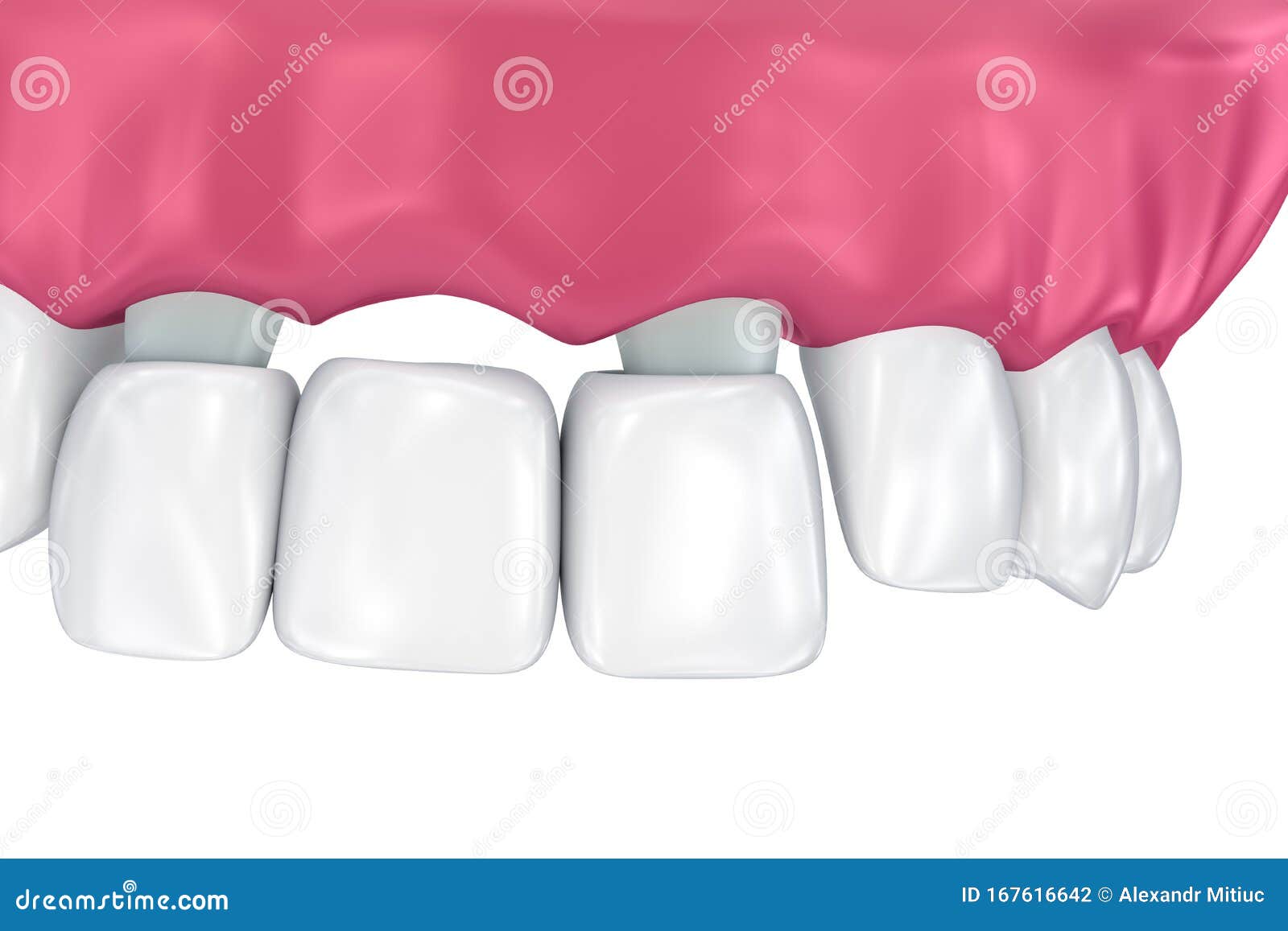 Tooth Supported Fixed Bridge. Medically Accurate Illustration Royalty ...