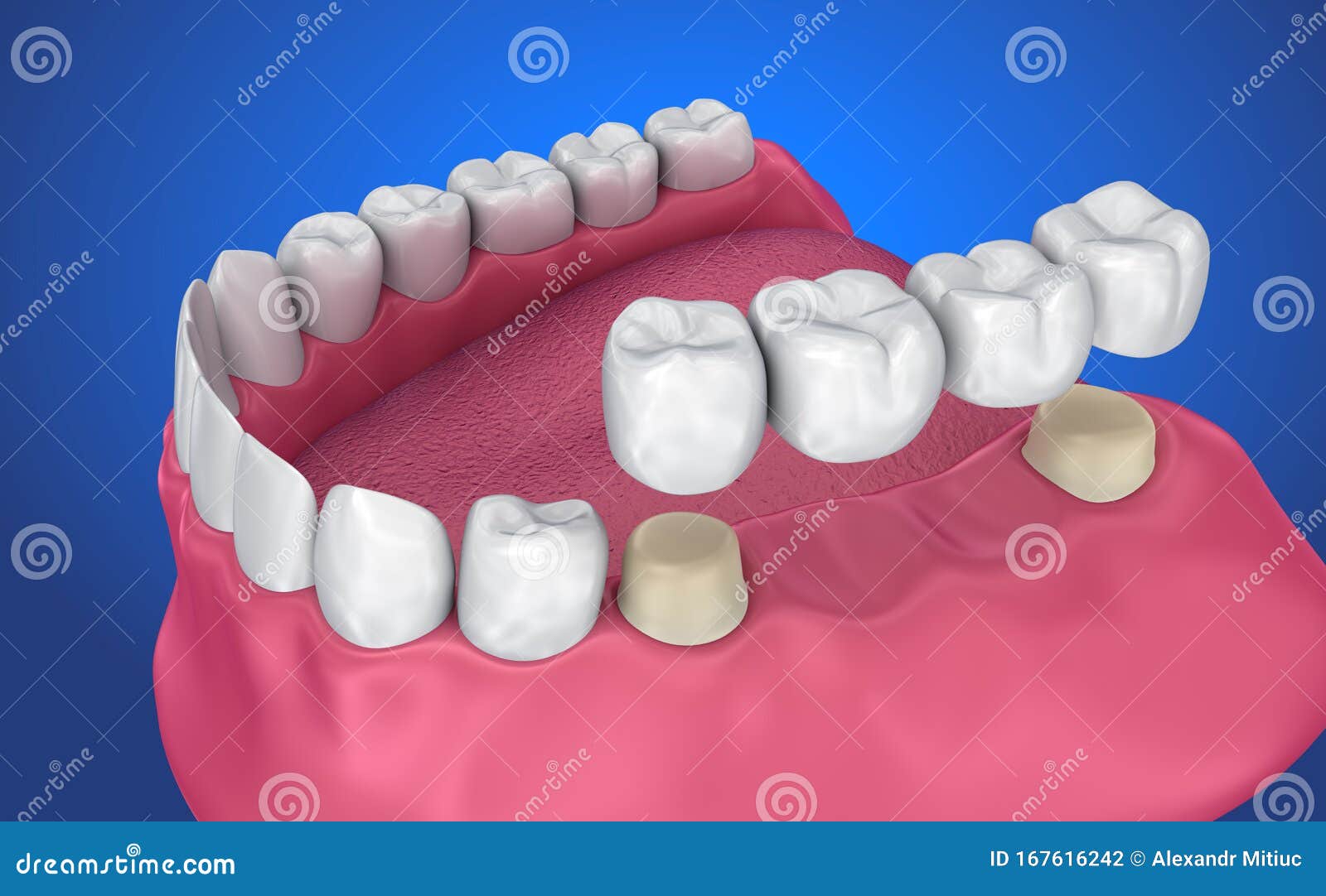 Tooth Supported Fixed Bridge. Medically Accurate Stock Illustration ...
