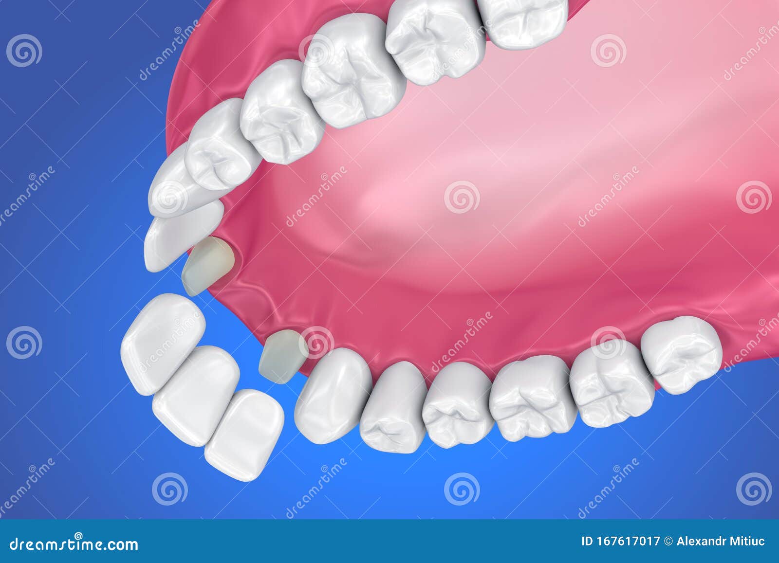 Tooth Supported Fixed Bridge. Medically Accurate Illustration Stock ...