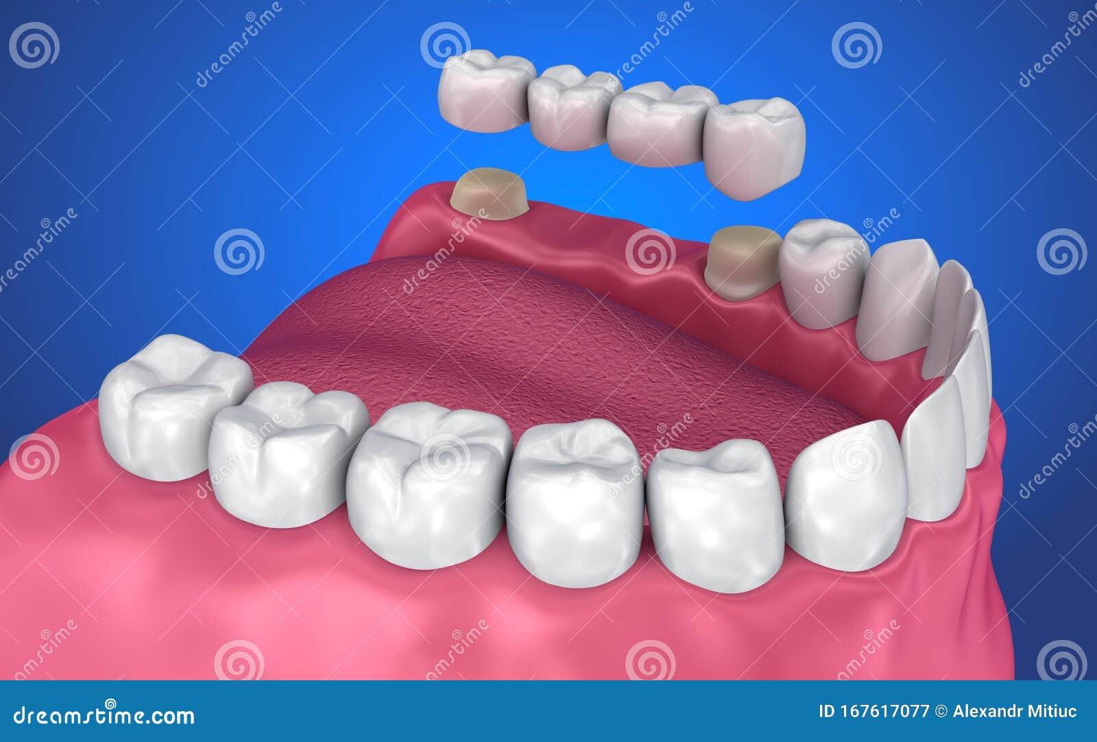 Tooth Supported Fixed Bridge. Medically Accurate Illustration Stock ...
