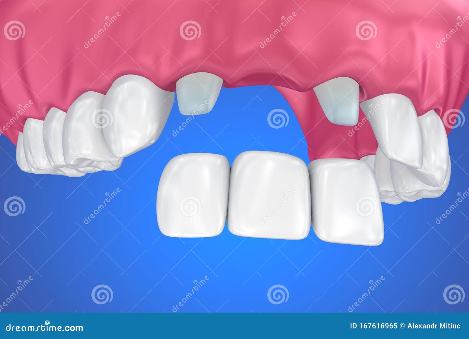 Tooth Supported Fixed Bridge. Medically Accurate Illustration Stock ...
