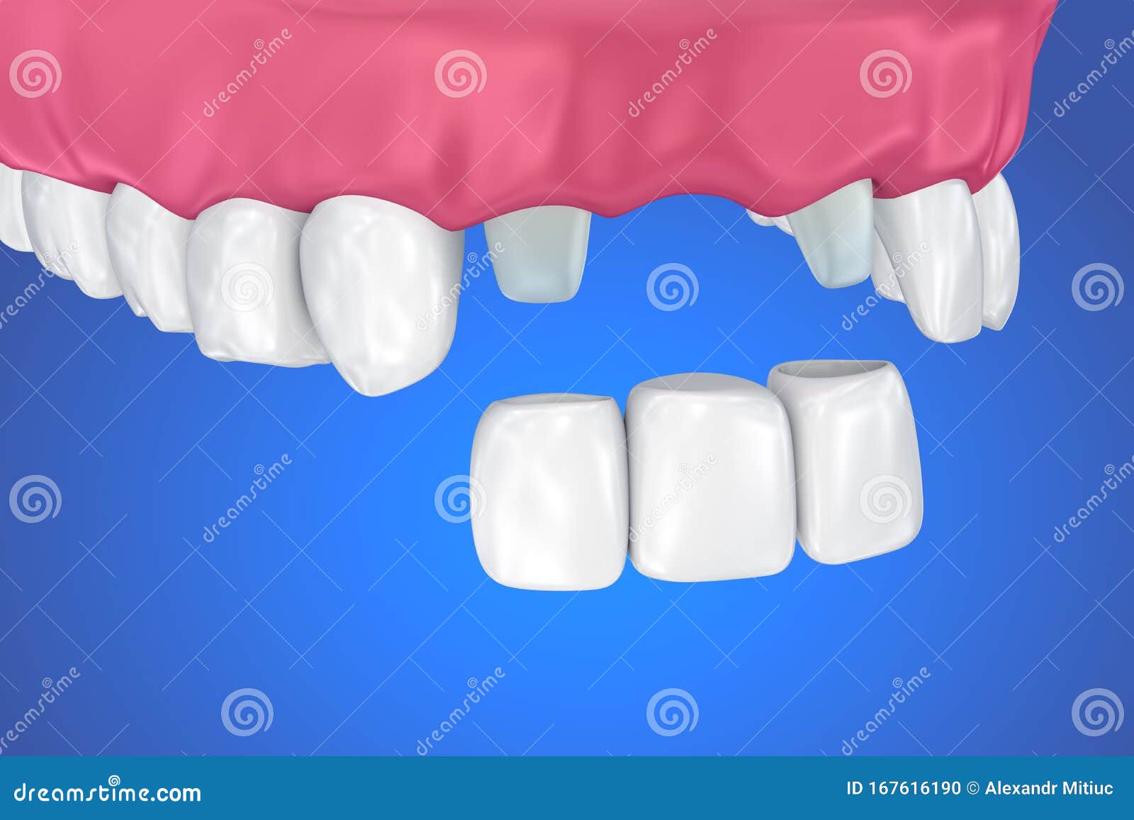 Tooth Supported Fixed Bridge. Medically Accurate Stock Illustration ...