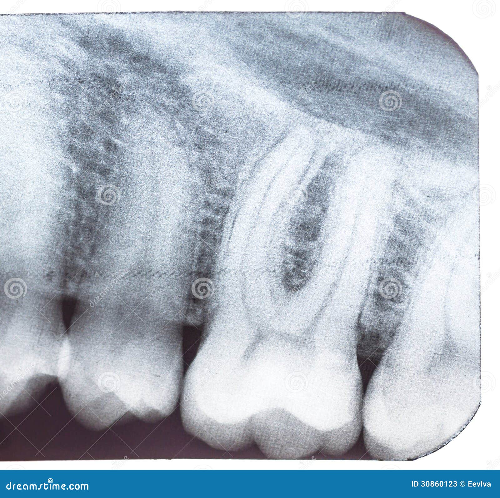 Tooth X-ray. Royalty-Free Stock Photography | CartoonDealer.com #30860123