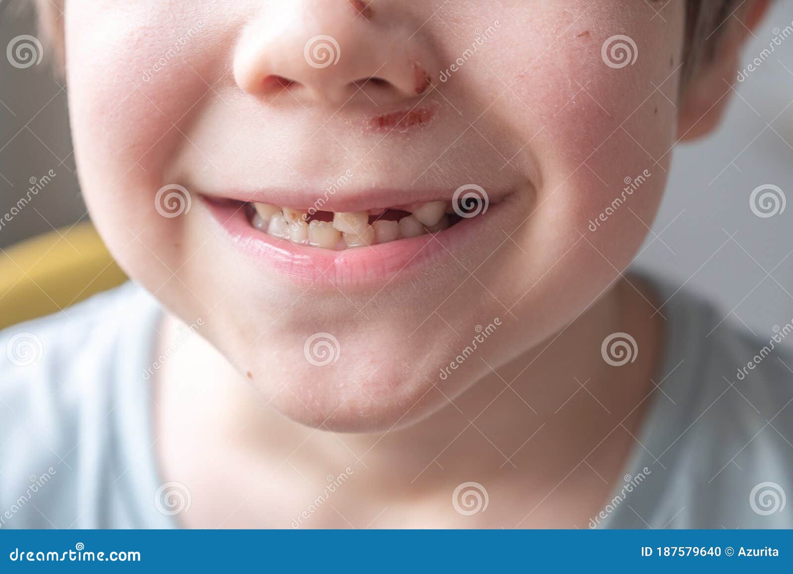 Toothless boy smiling stock photo. Image of dentistry - 187579640