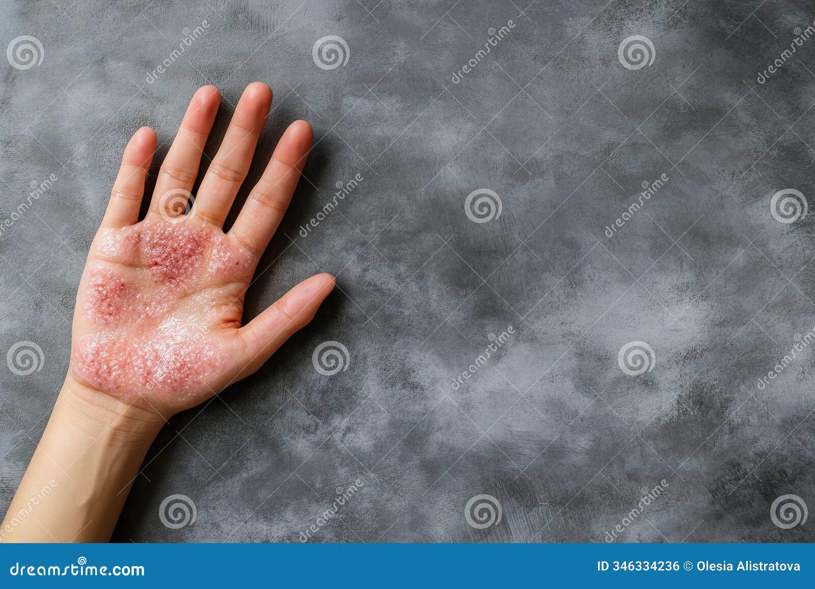 Top-Down View of Monkeypox Blisters on Hand, Red Rash on Palms. with ...