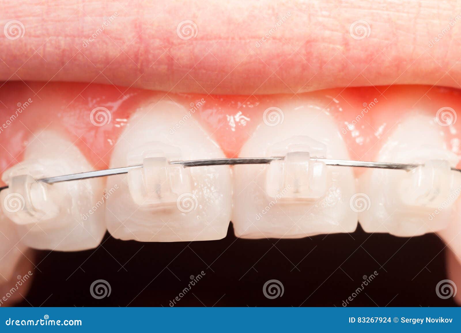 Top Tooth Alignment with Ceramic Braces Stock Photo - Image of open ...