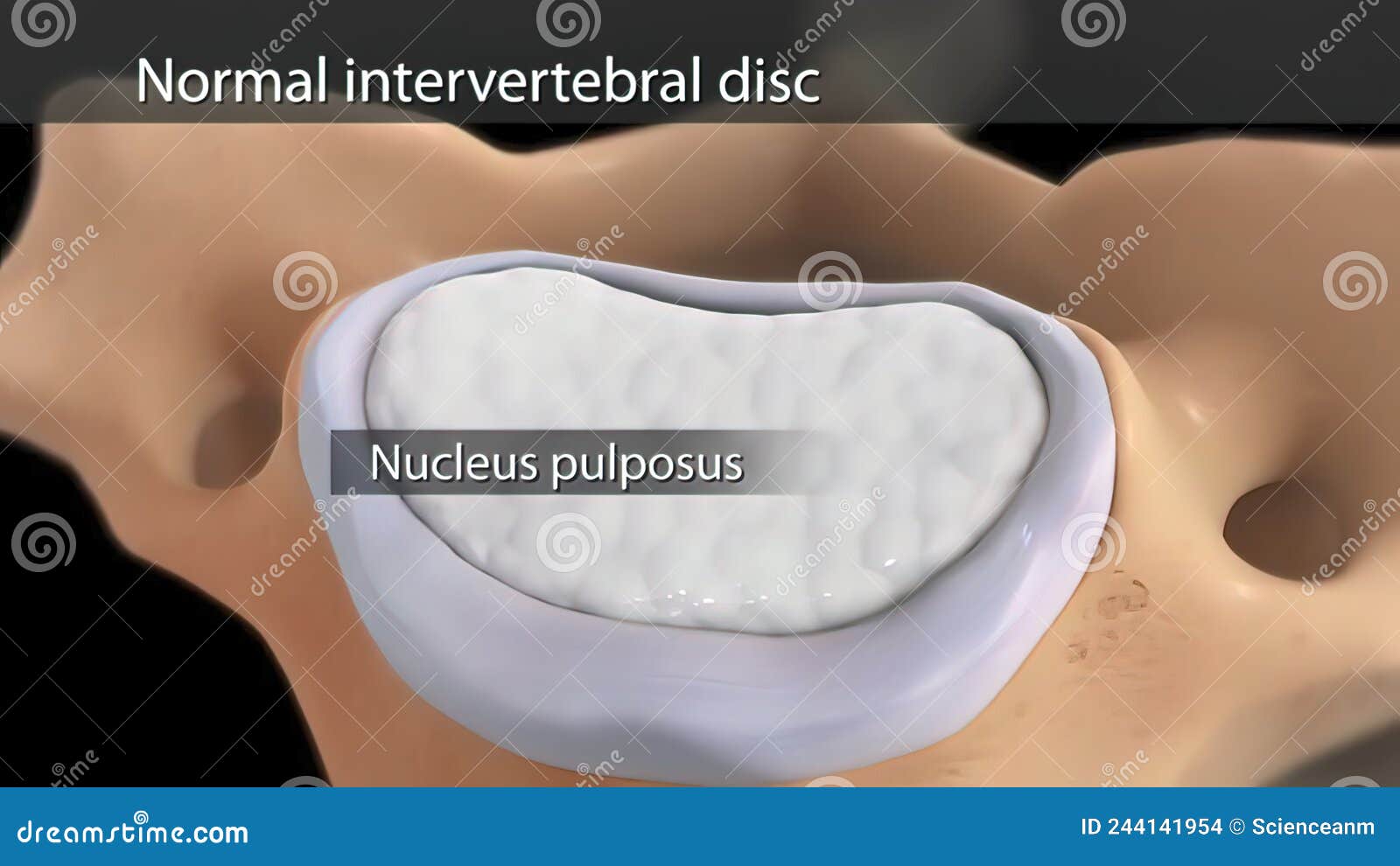 Normal Disc And Herniated Disc, Slipped Disc, Labelde Illustration ...