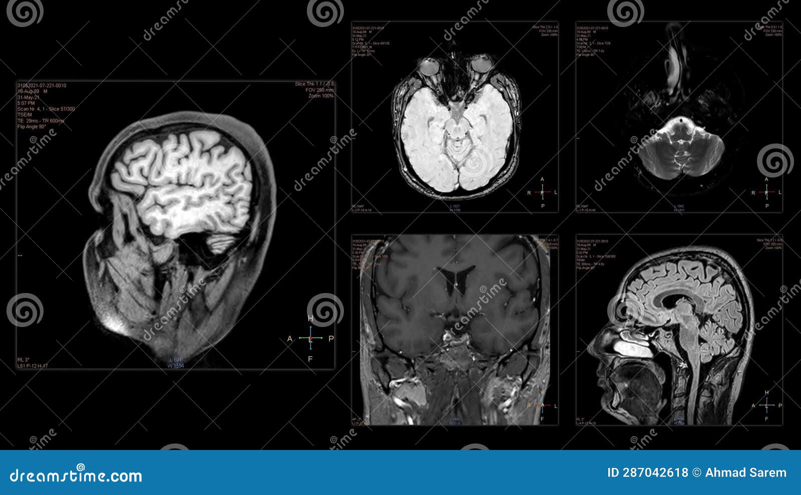 Head MRI Scan from Different Angles Stock Photo - Image of head, mouth ...