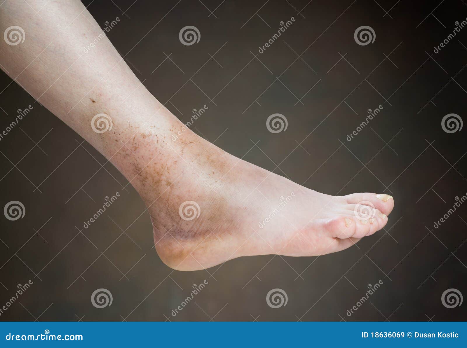 Torcedura do tornozelo imagem de stock. Imagem de tiro - 18636069