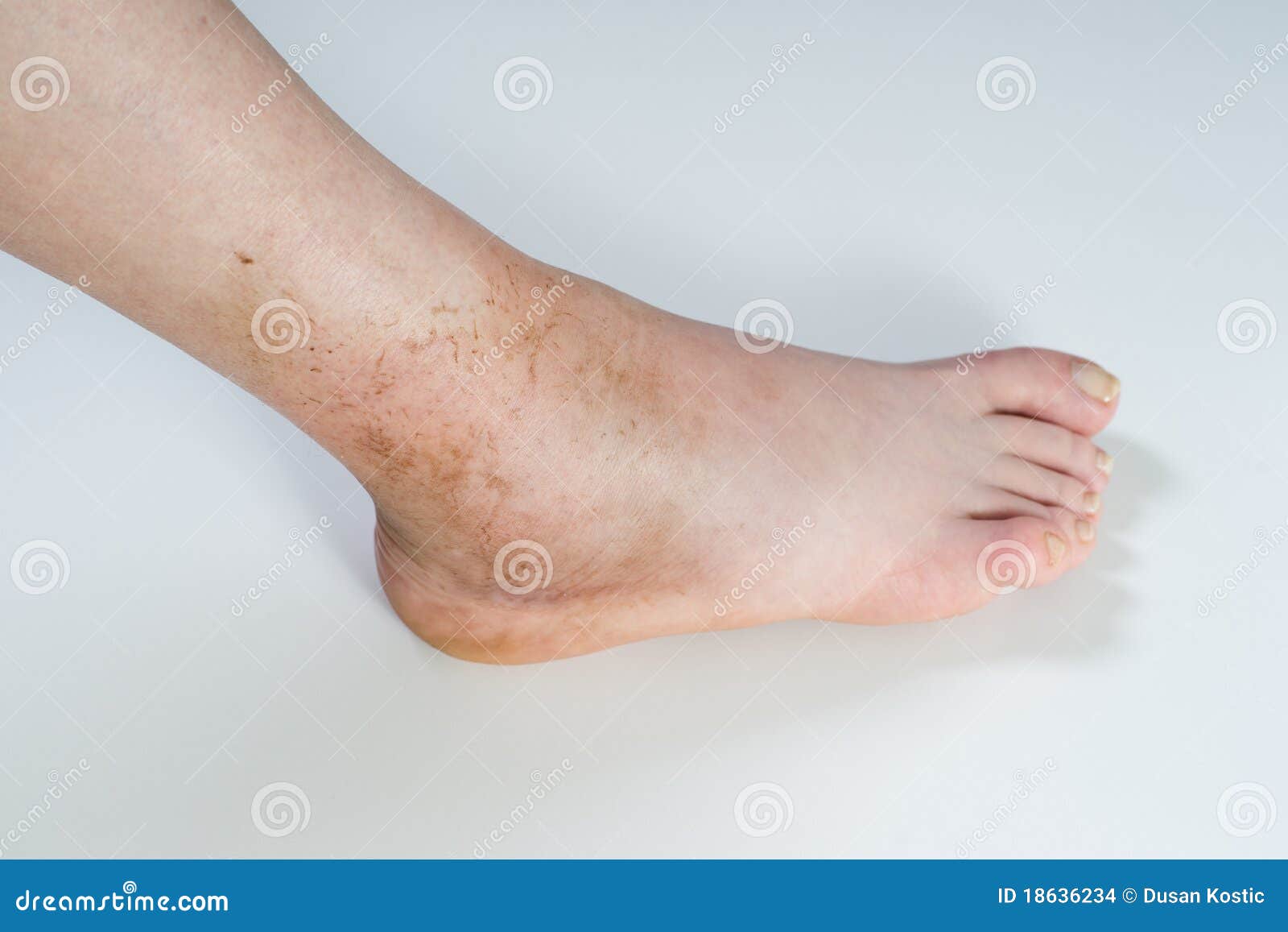 Torcedura do tornozelo foto de stock. Imagem de ferida - 18636234