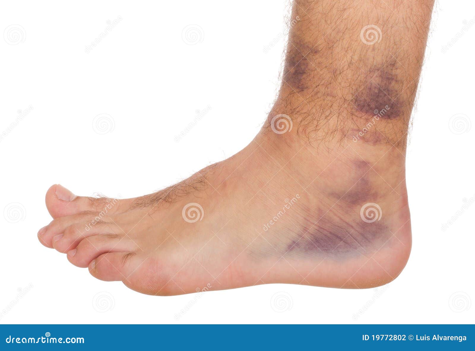 Torcedura do tornozelo foto de stock. Imagem de adulto - 19772802