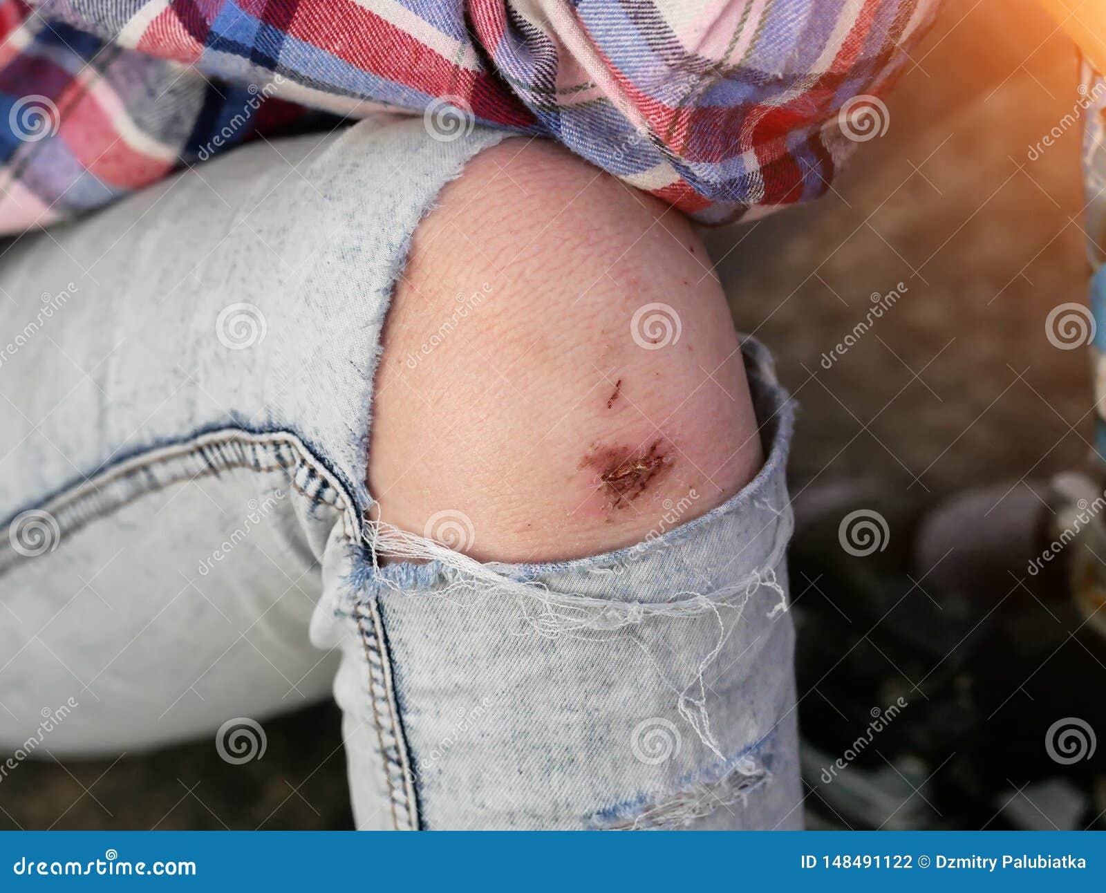 Torn Jeans and a Broken Knee. Open Wound Stock Photo - Image of ...