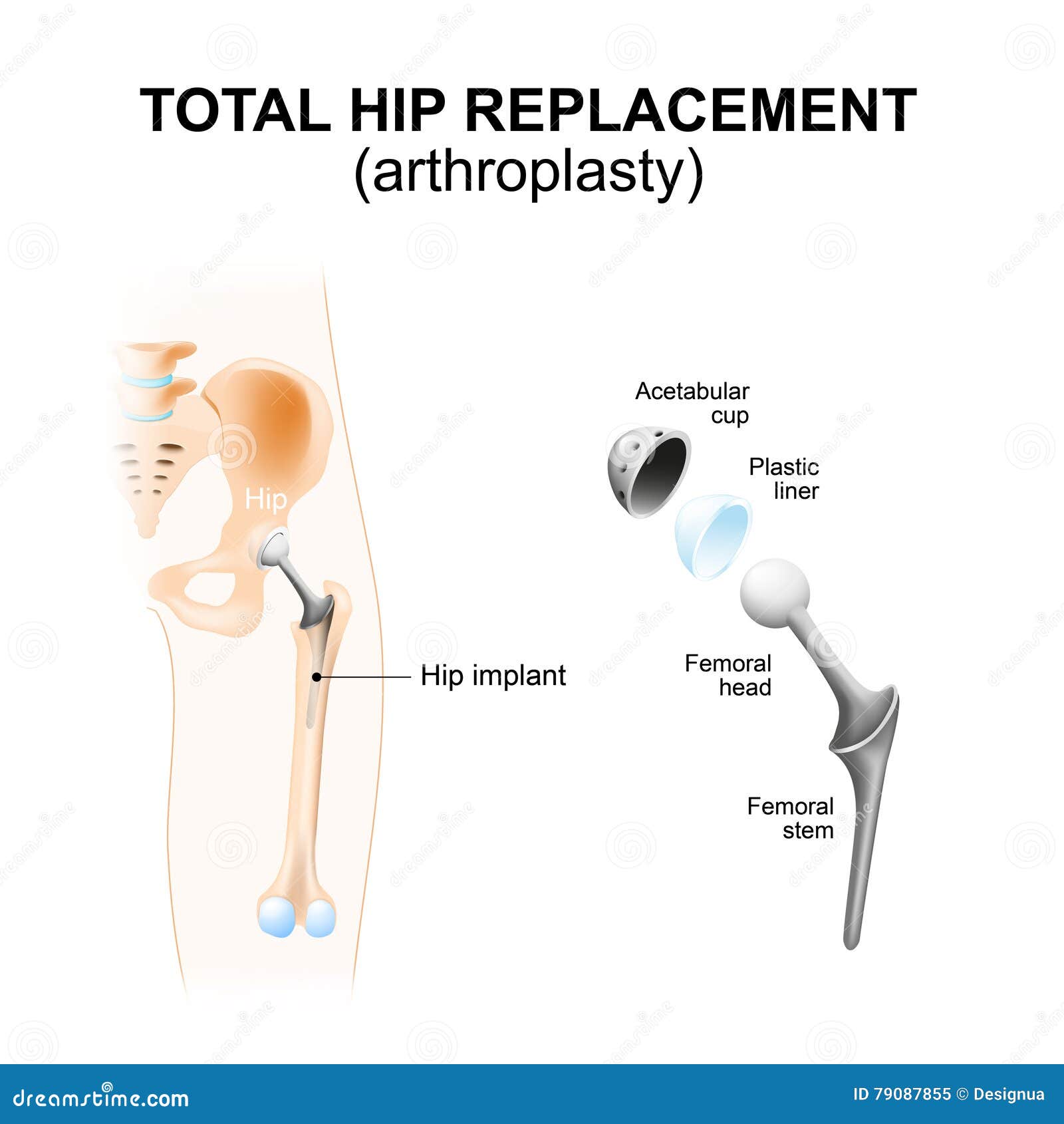 Total Hip Replacement or Arthroplasty. Stock Vector - Illustration of ...