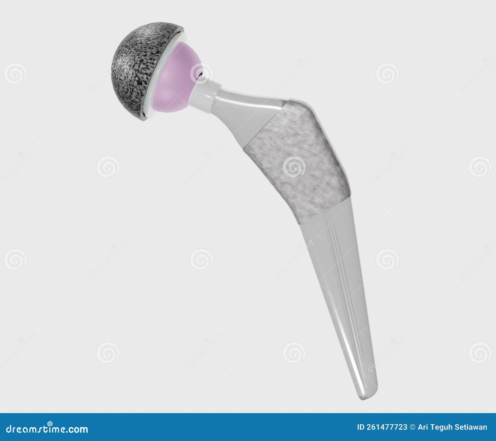 Total Hip Replacement Components And Examples Of Commercial Hip Stem ...