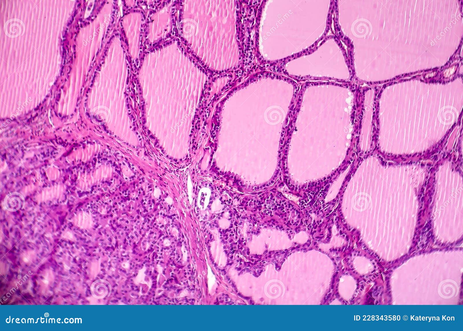 Toxic Diffuse Goiter, or Graves Disease, Light Micrograph Stock Photo ...