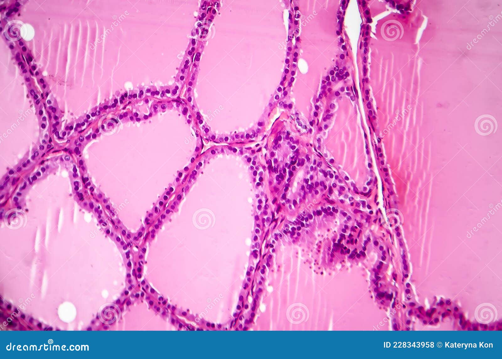Toxic Diffuse Goiter, or Graves Disease, Light Micrograph Stock Photo ...