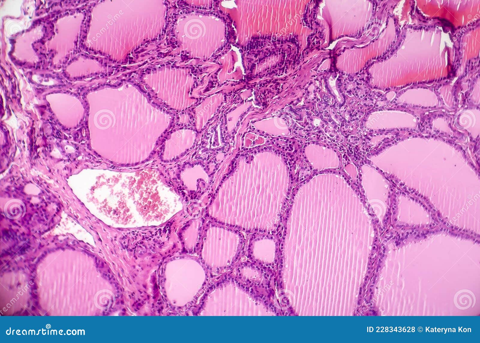 Toxic Diffuse Goiter, or Graves Disease, Light Micrograph Stock Photo ...